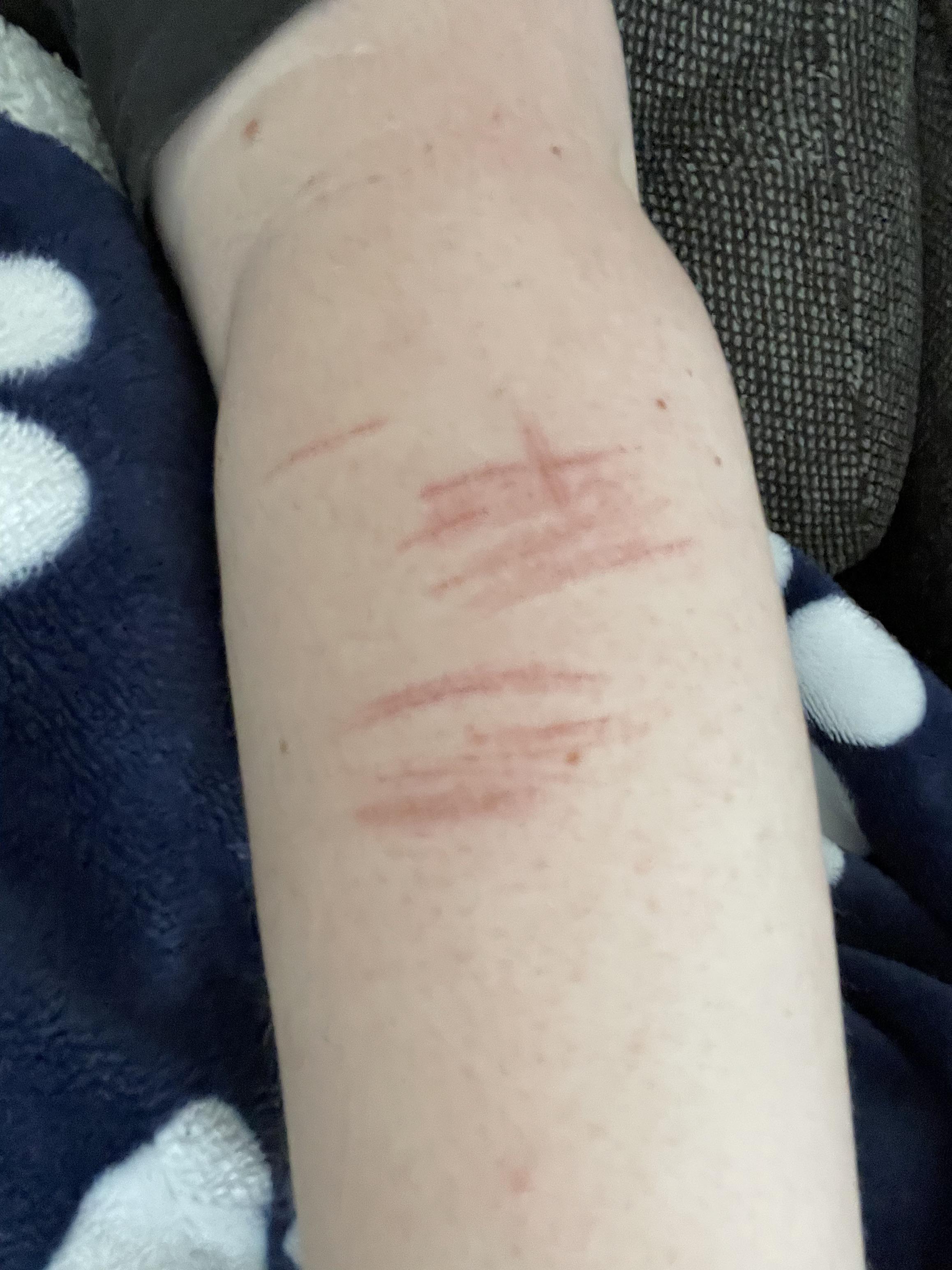 First time. Scared of how much it helped. How easy it was. More on my upper arm too. | Scrolller