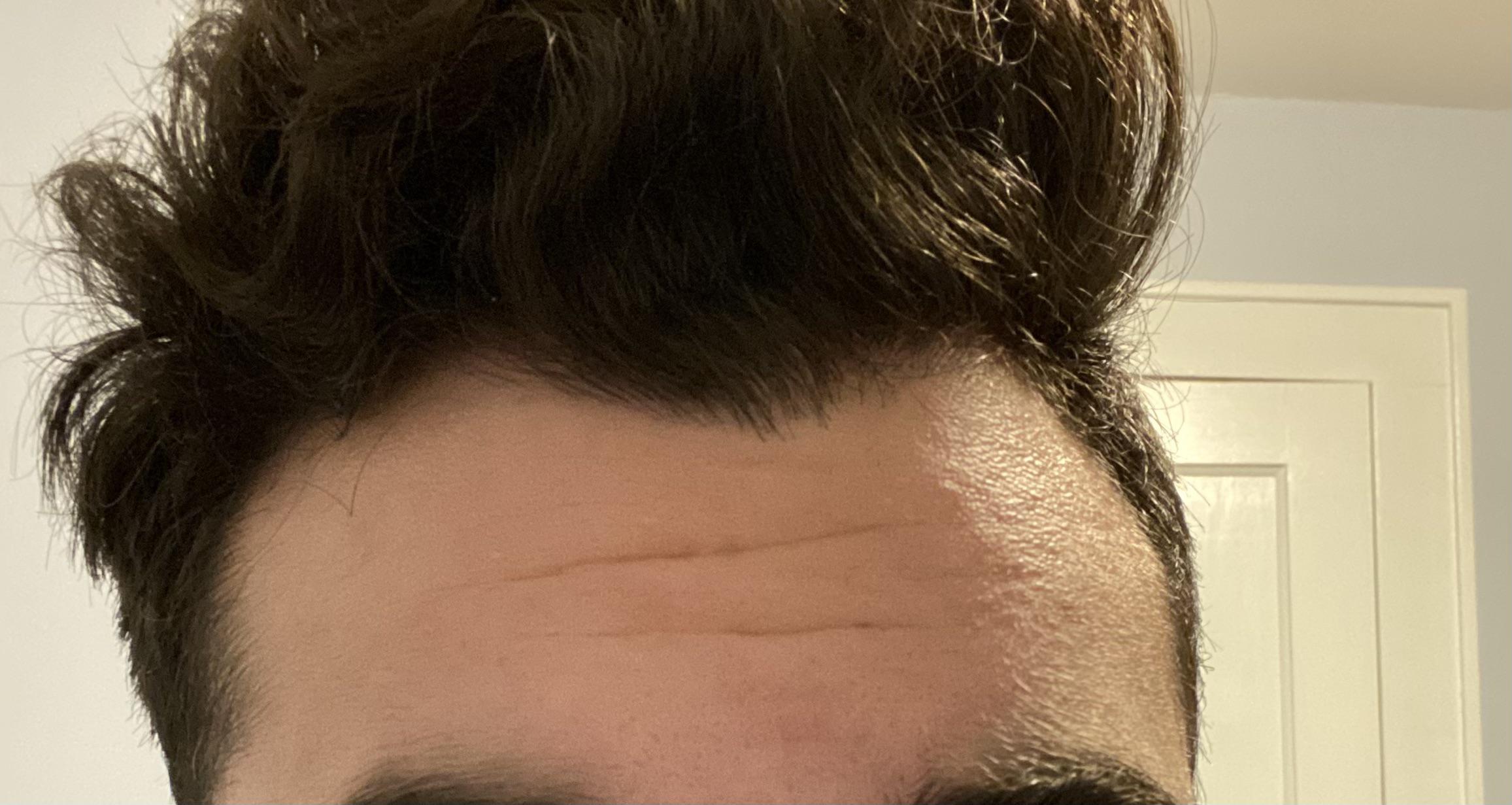 Forehead wrinkles 23m | Scrolller