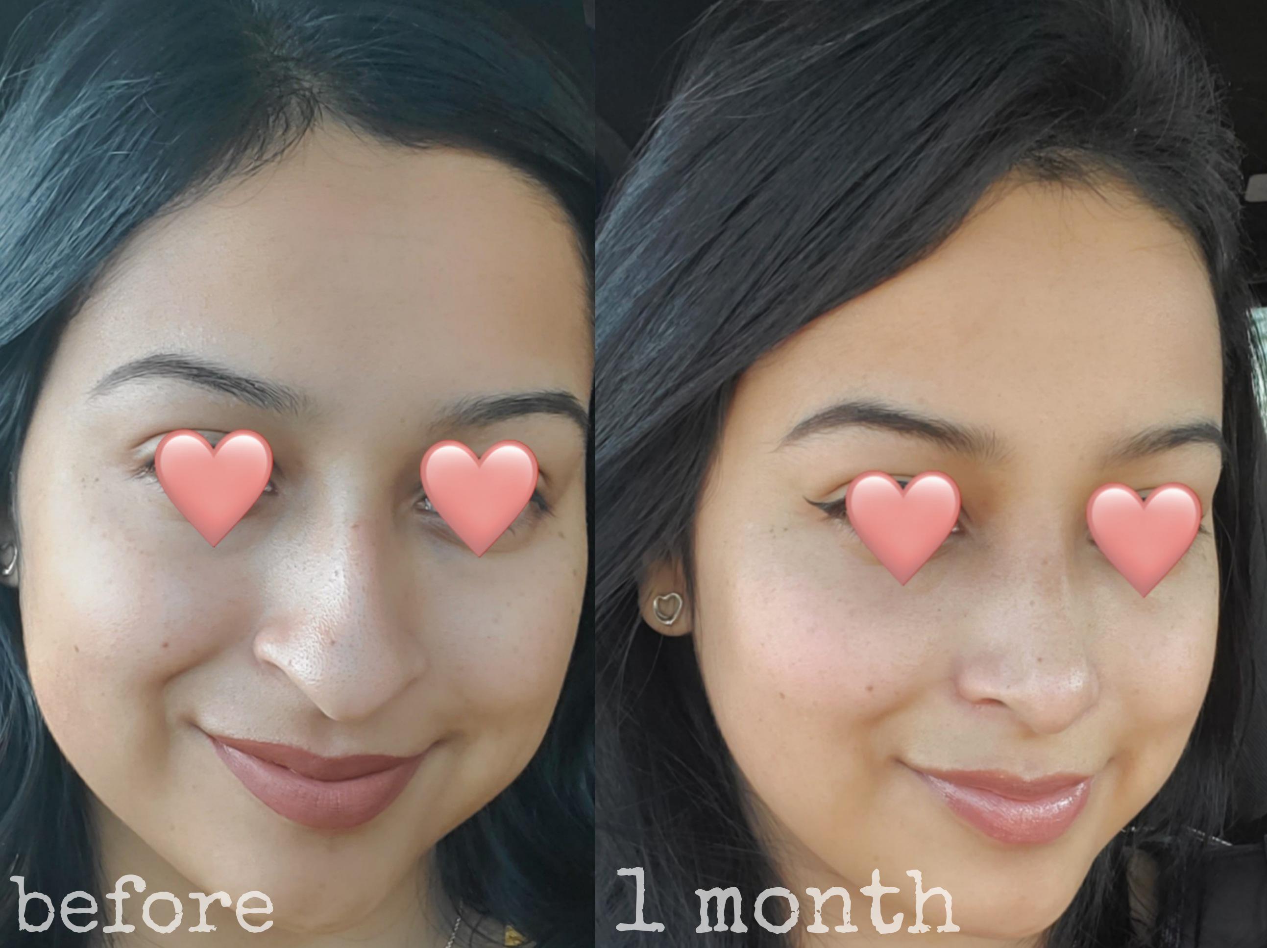 Front view of my nose 1 month post op! | Scrolller