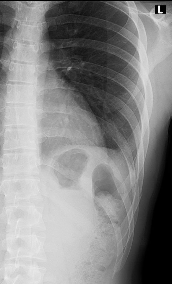 Help reading broken ribs and apparent Internal bleeding | Scrolller