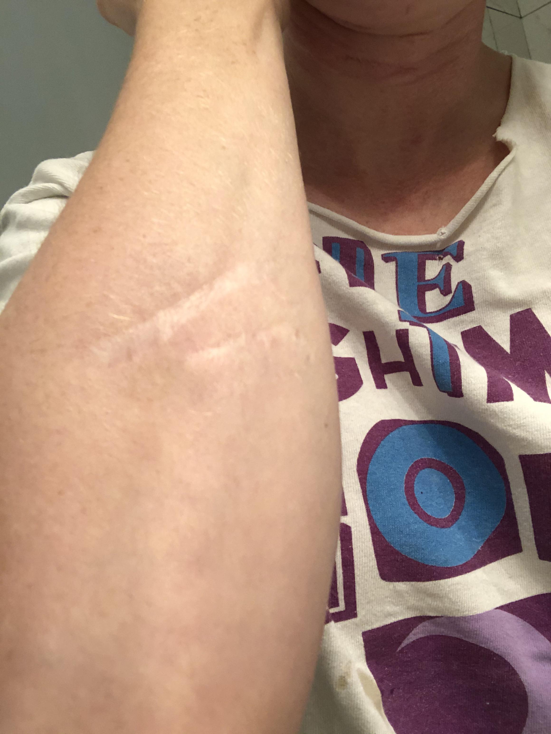 Here are some scars from the glass door incident. There were three big cuts, it took almost 30 ...