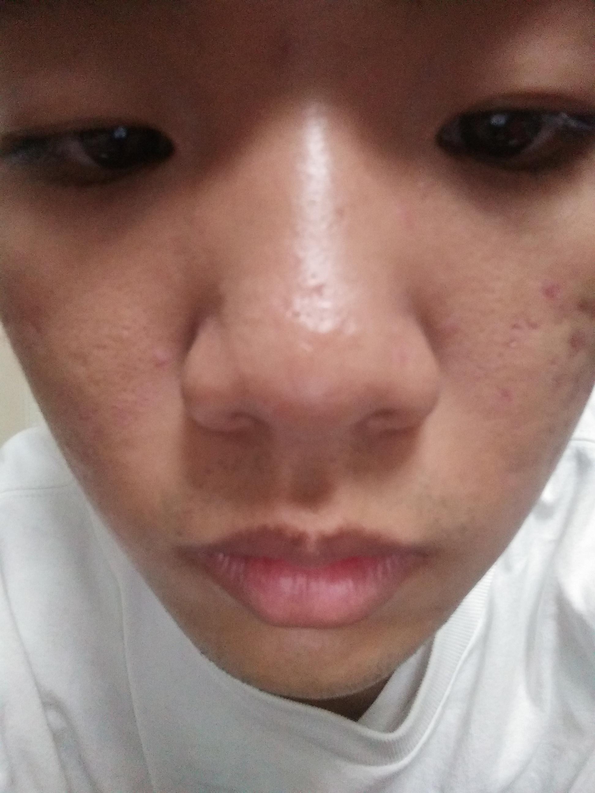 How Do I Fix These Acne Scars Especially These Nasty Scars On My Nose How Do I Fix These Acne Scars Especially These Nasty Scars On My Nose