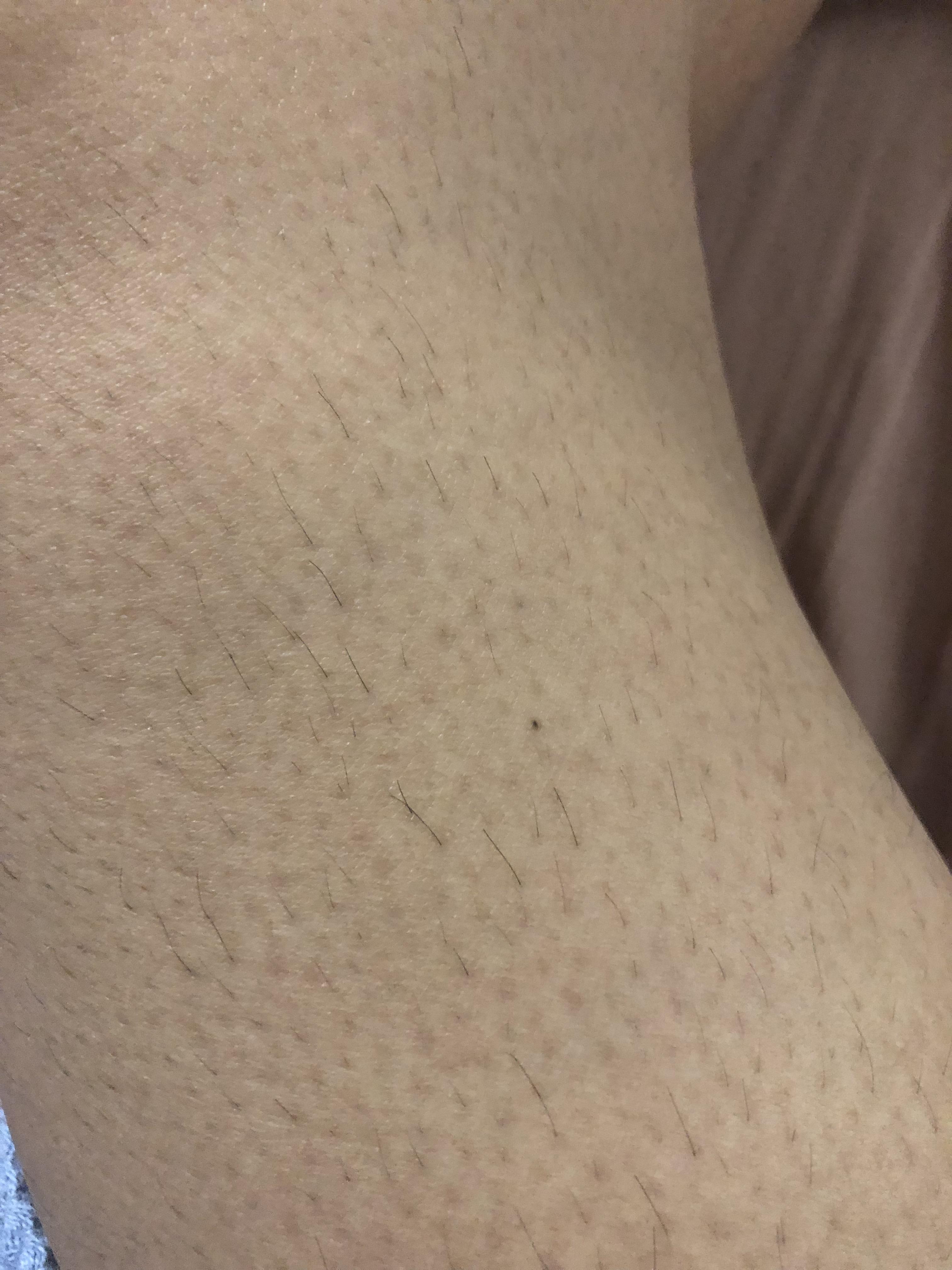 Is this keratosis Pilaris? Or just bad skin texture? | Scrolller