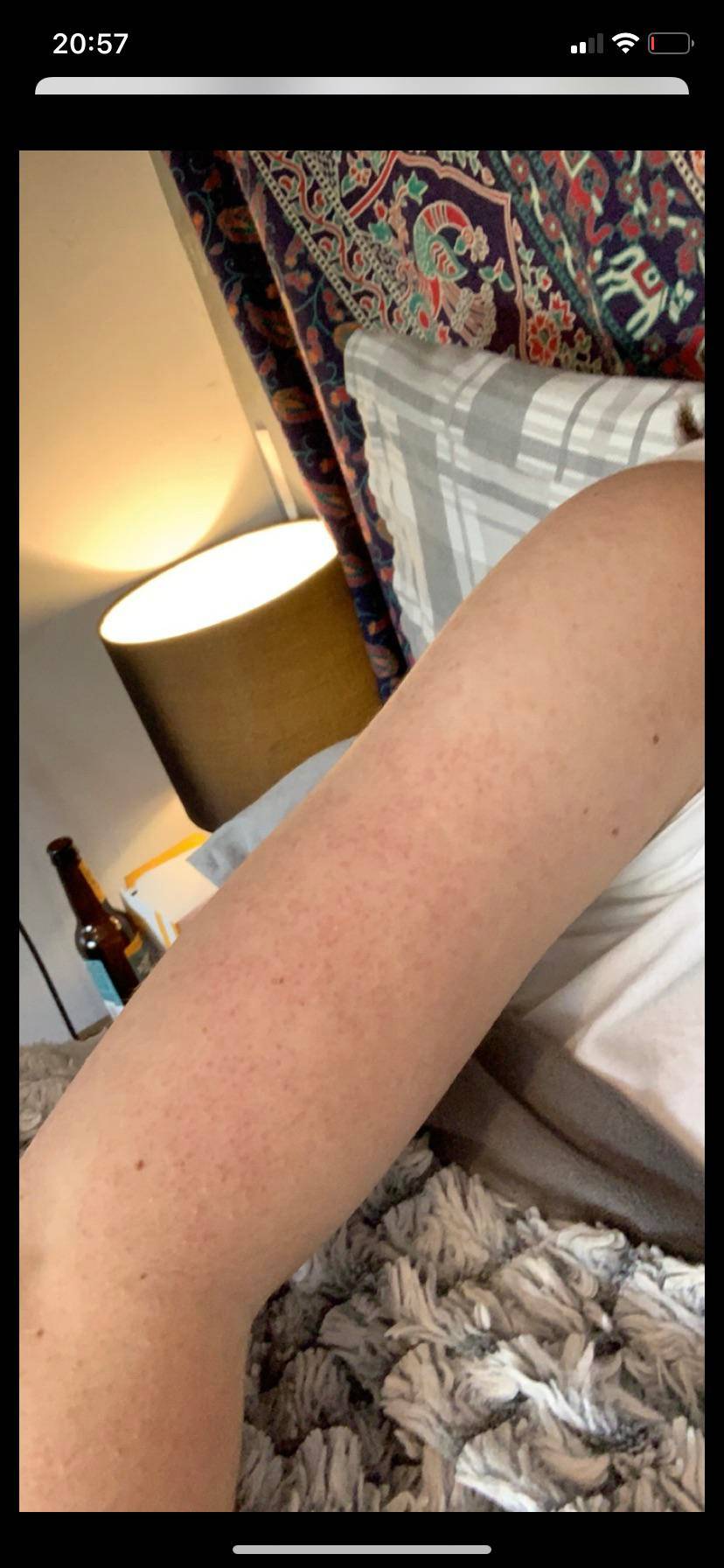 Keratosis on upper arms experience and tips. | Scrolller