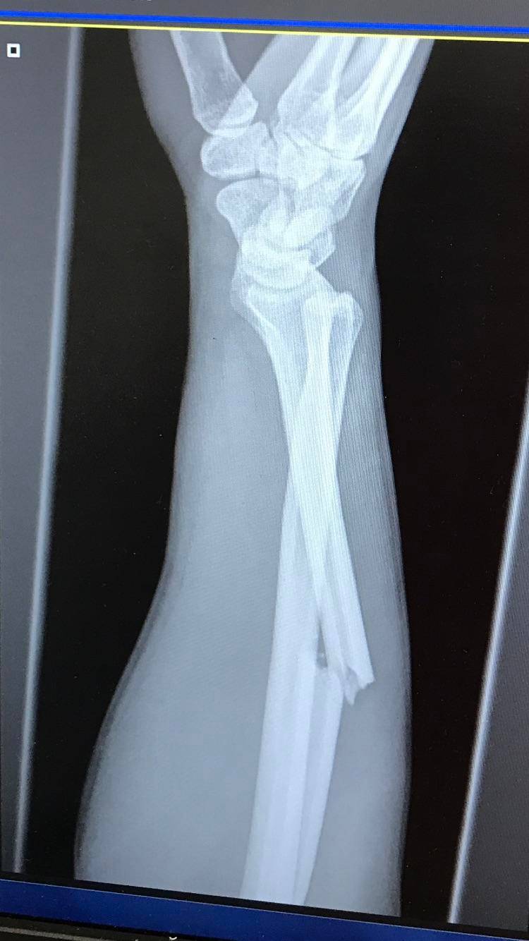 Little Galeazzi Fracture | Scrolller