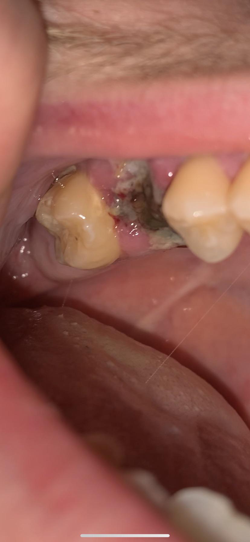 Looking for some help, does this look like dry socket? I’m on 48 hours after my tooth extraction ...