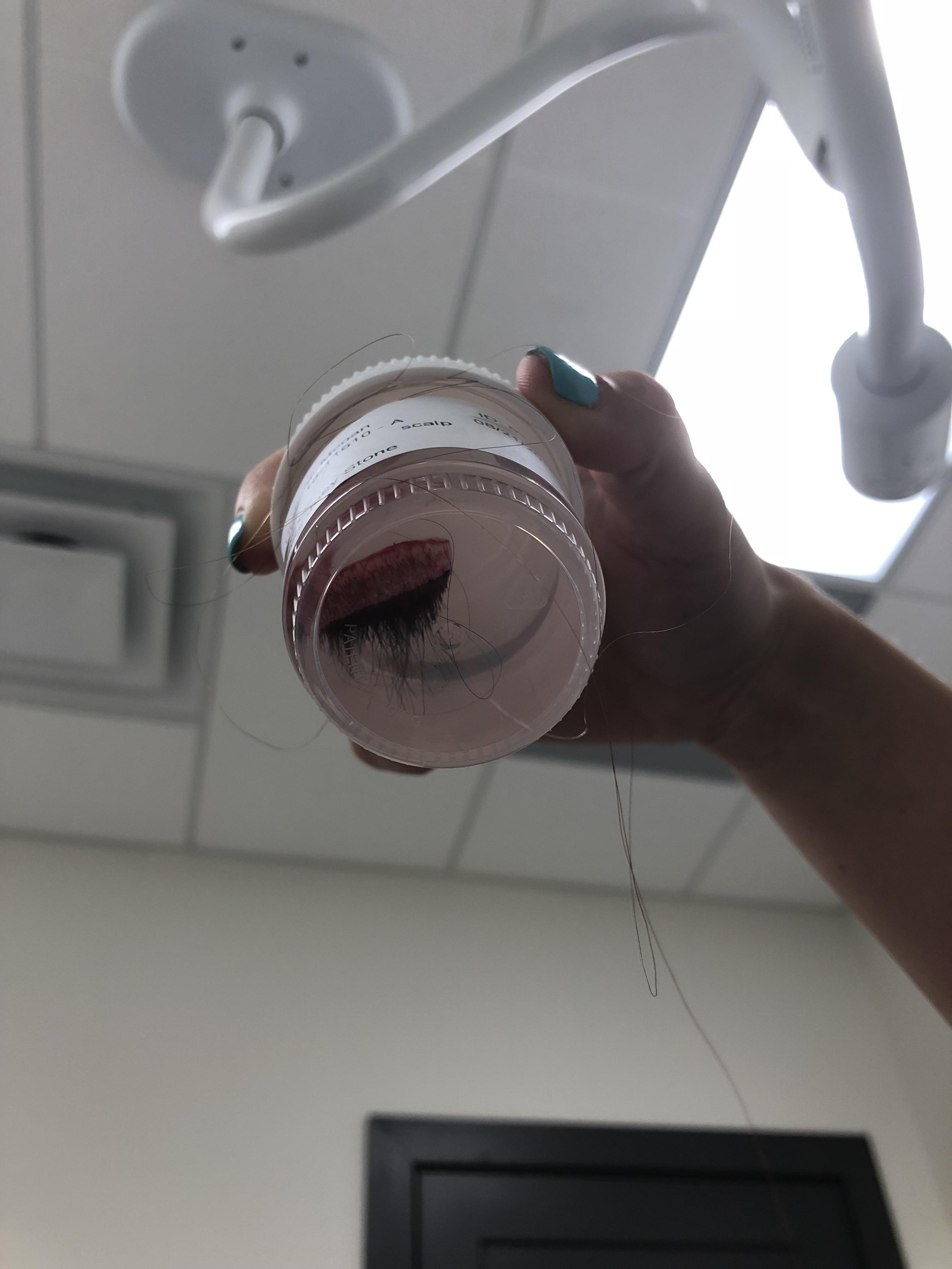 Melanoma removal | Scrolller