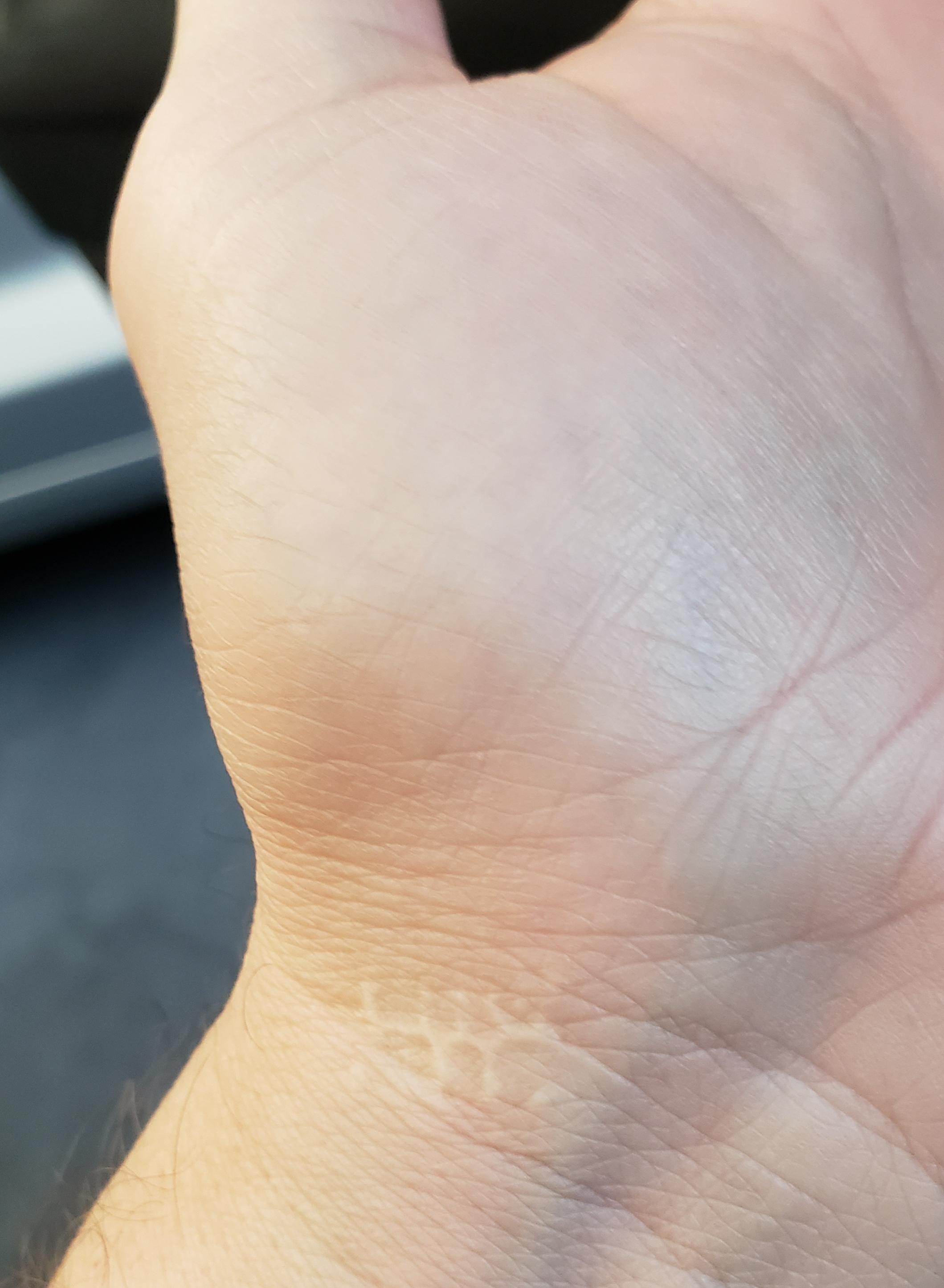 My Frankenstein scar. | Scrolller