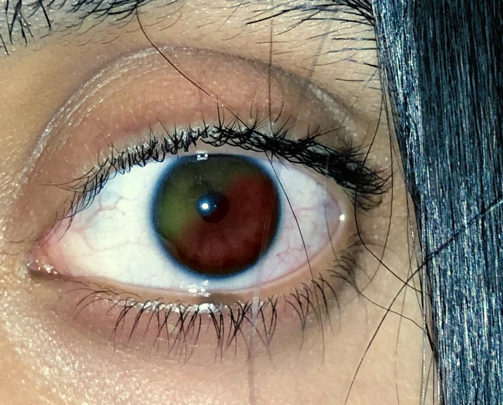 My one eye... | Scrolller