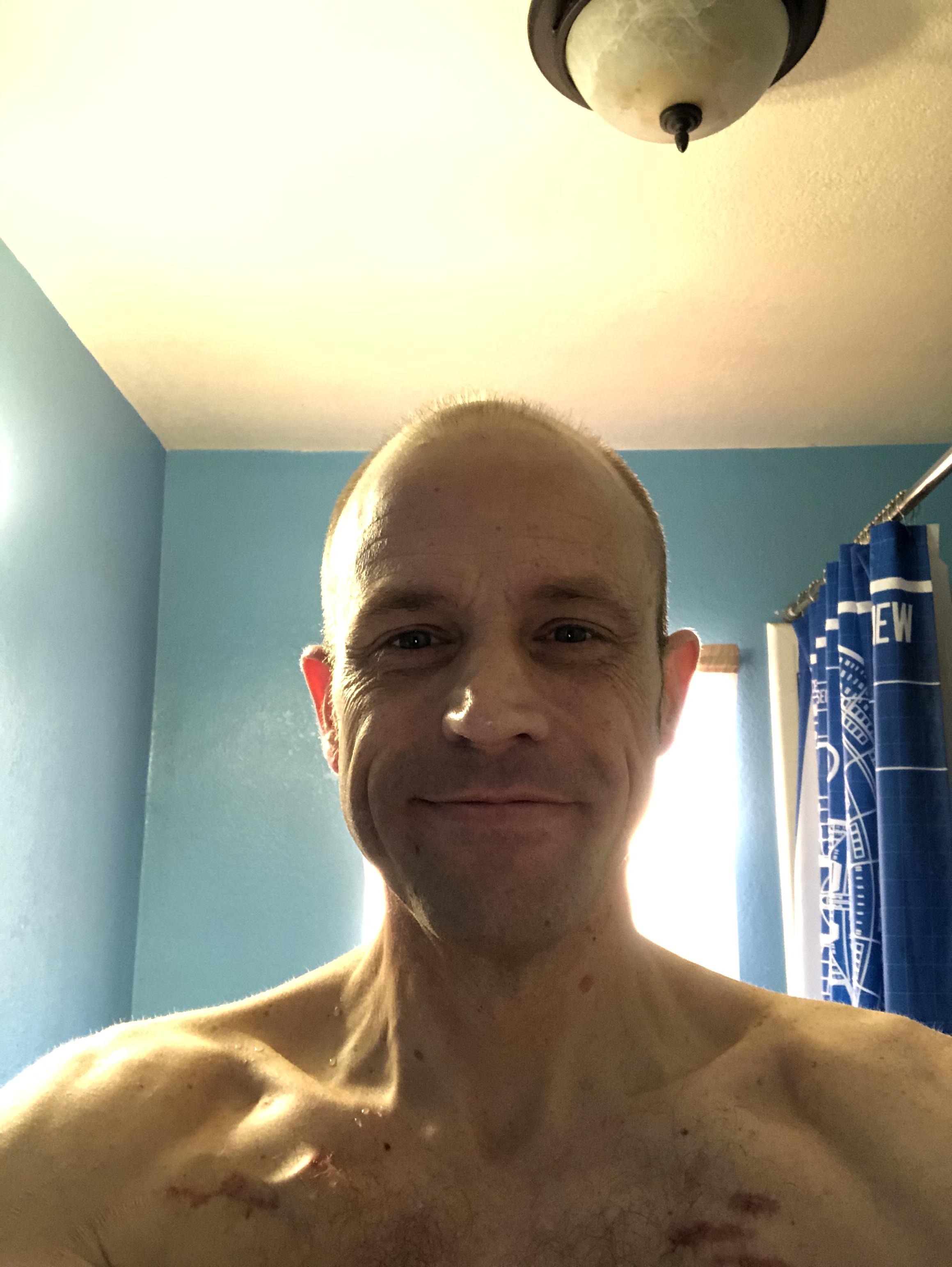 My port and pacemaker scars. | Scrolller