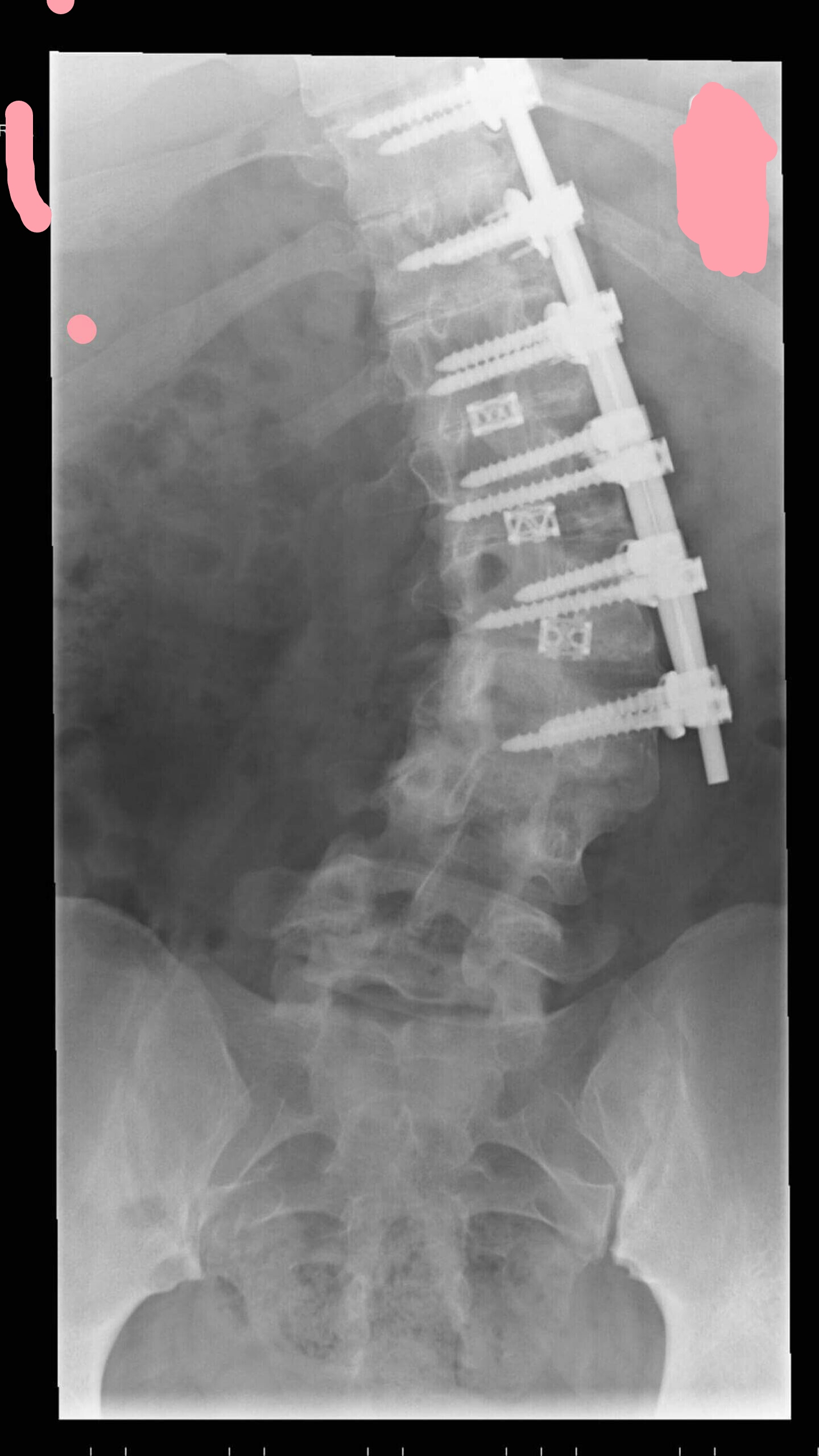 My scoliosis spinal fusion | Scrolller