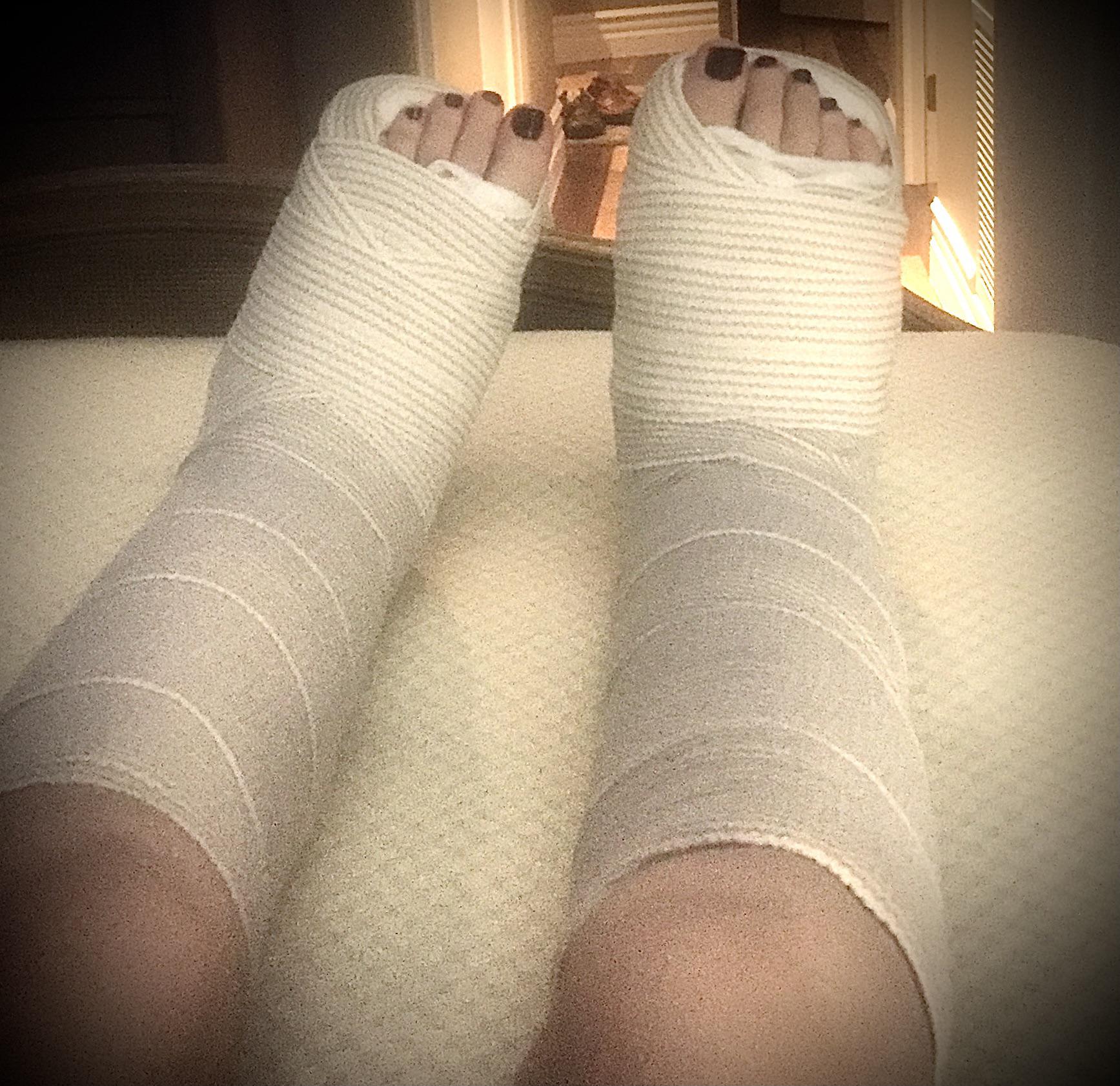 My two messed up ankles in bandages. | Scrolller