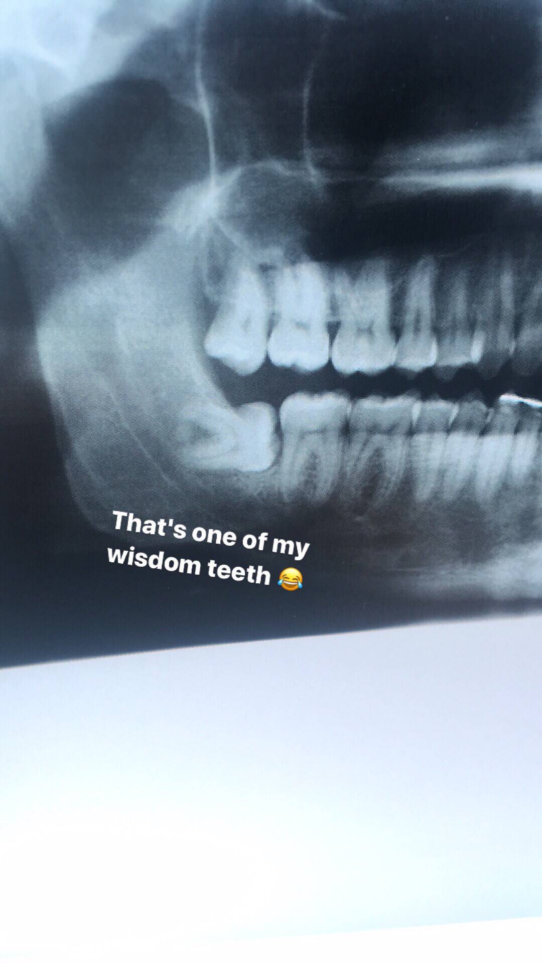 My wisdom teeth doing unwise things | Scrolller