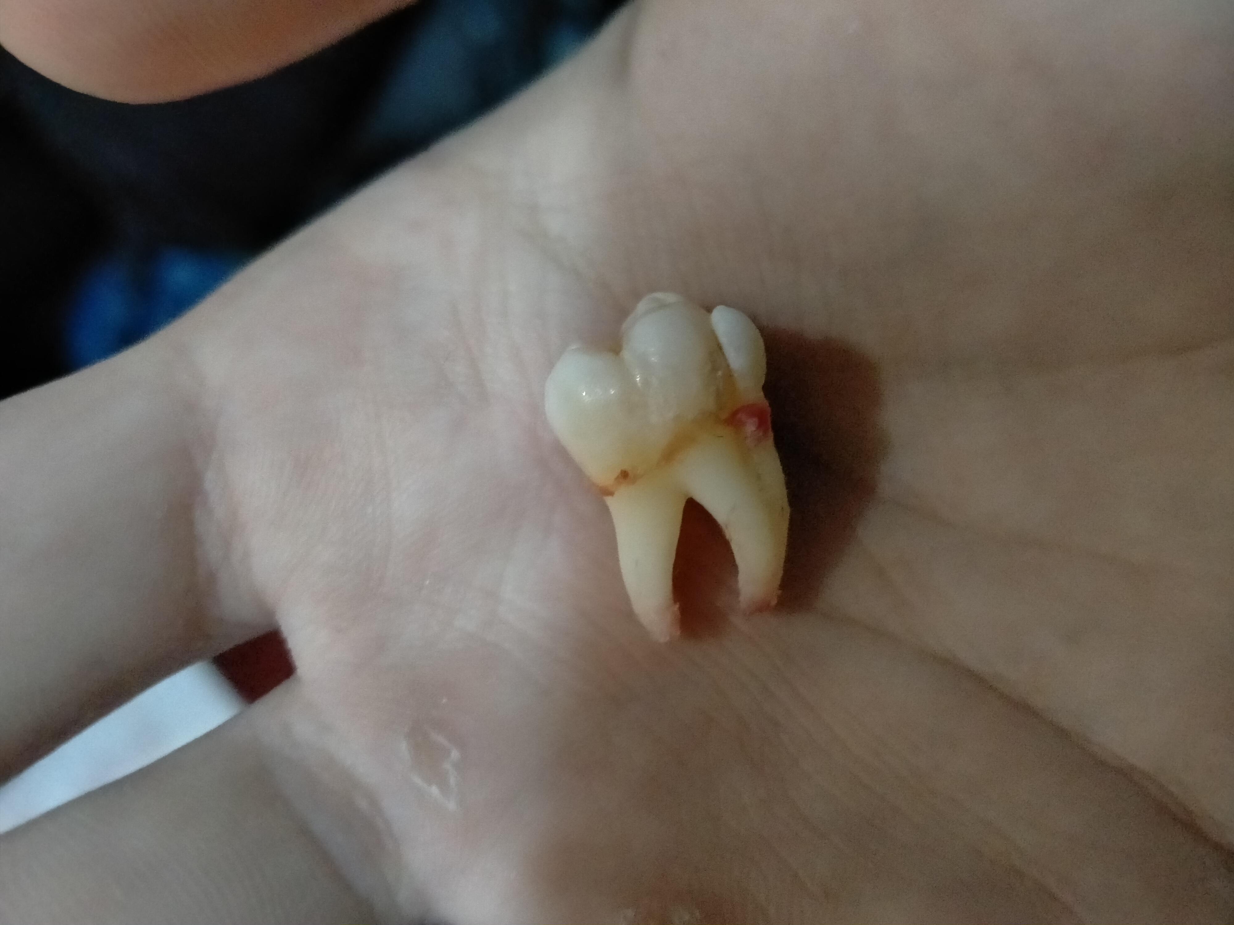 my wisdom teeth. what should i do with it | Scrolller