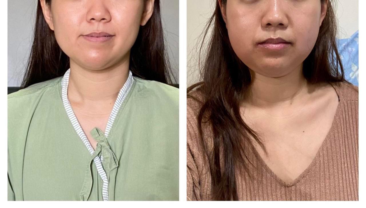 One week post op | Scrolller