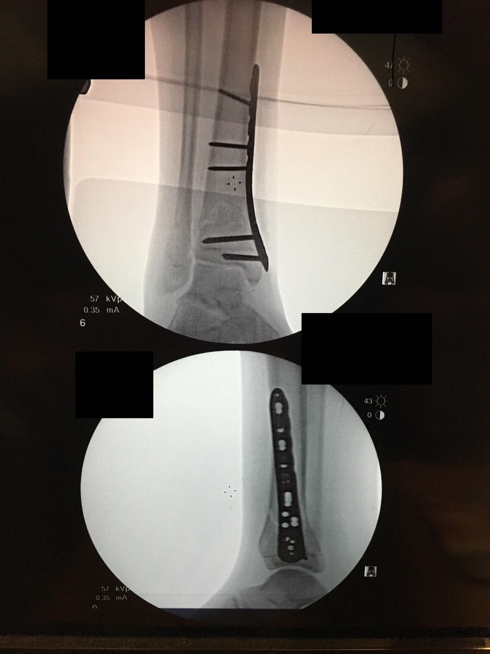 Plate for a broken ankle | Scrolller