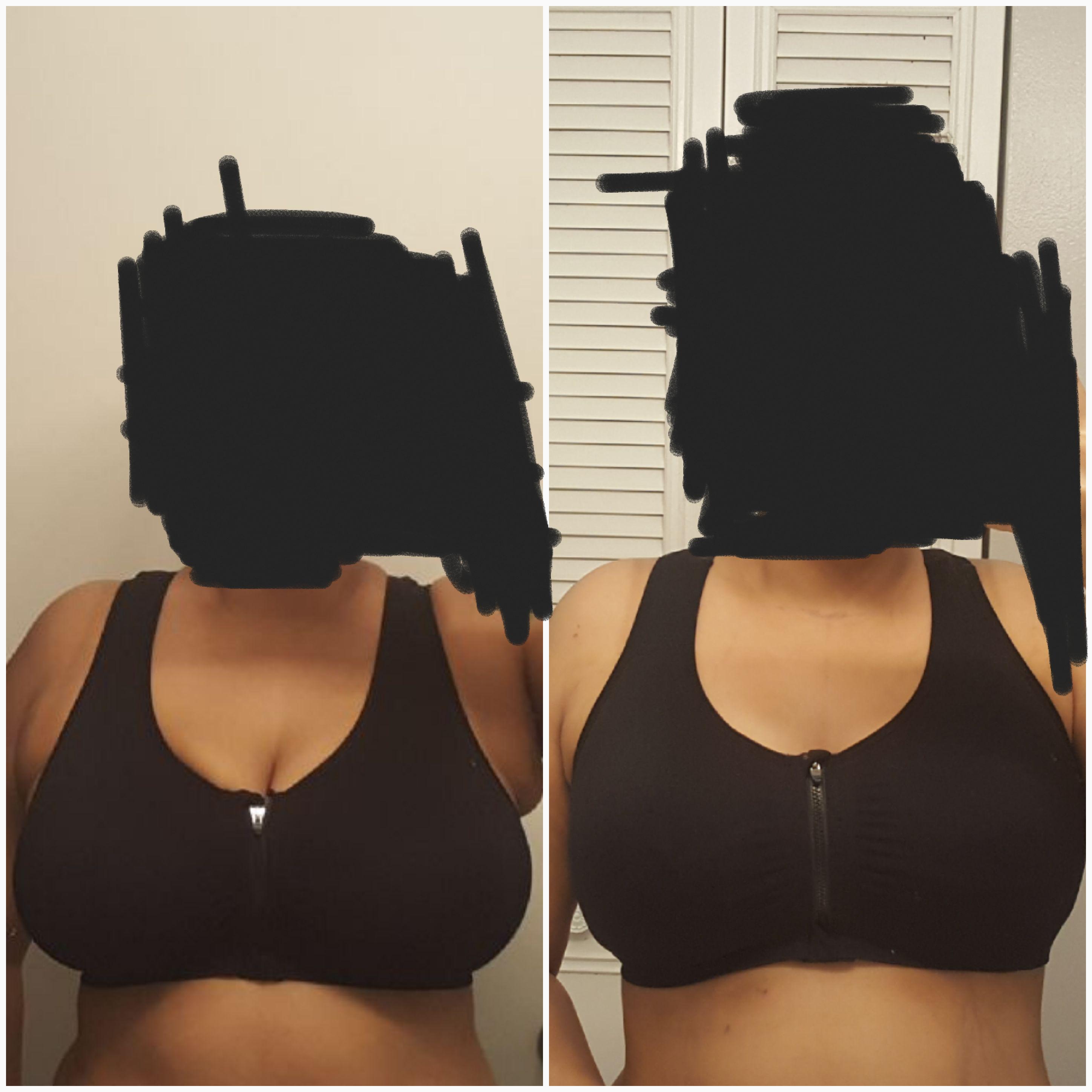Pre op ---> 5 days post op, same bra (I'm currently almost 3 weeks post op so they've gotten a ...