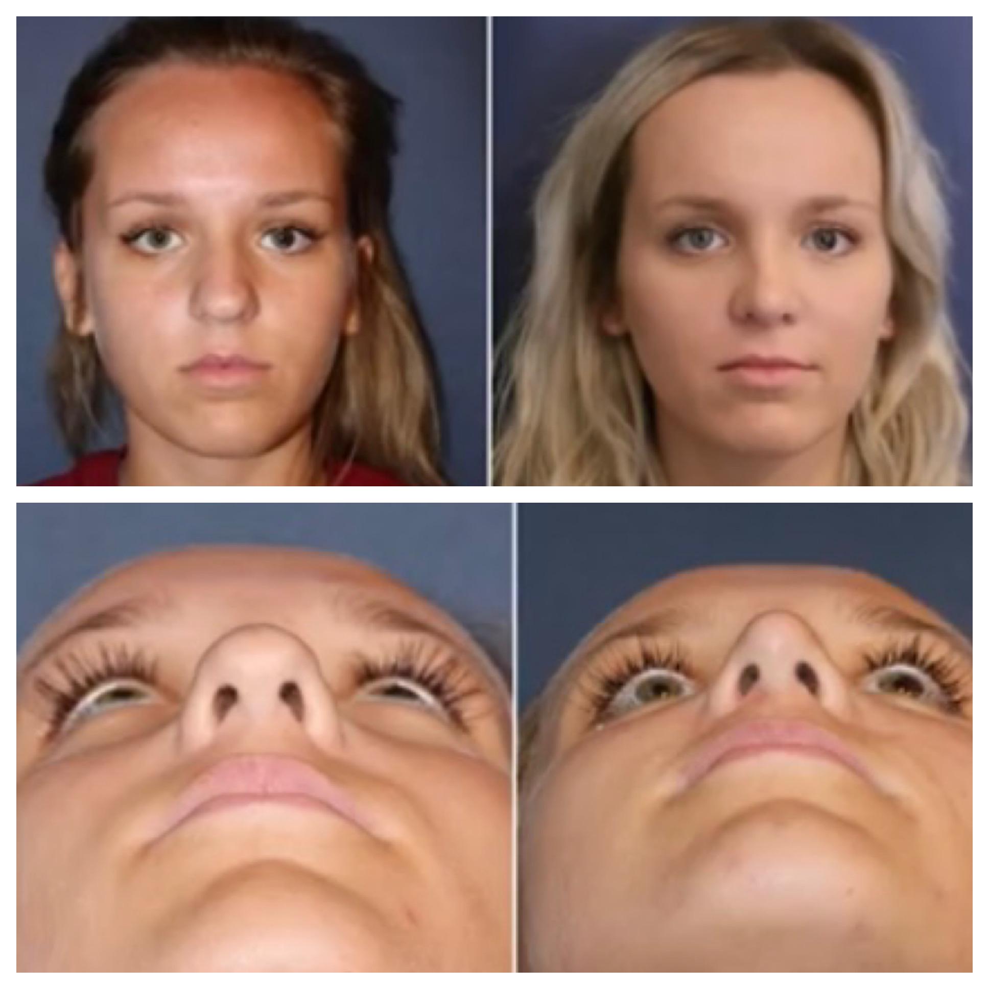 Rhinoplasty, septoplasty, and turbinate reduction - before and after both angles! | Scrolller