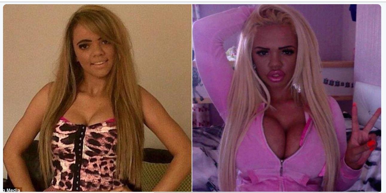 Silicone lips and tits are essential | Scrolller