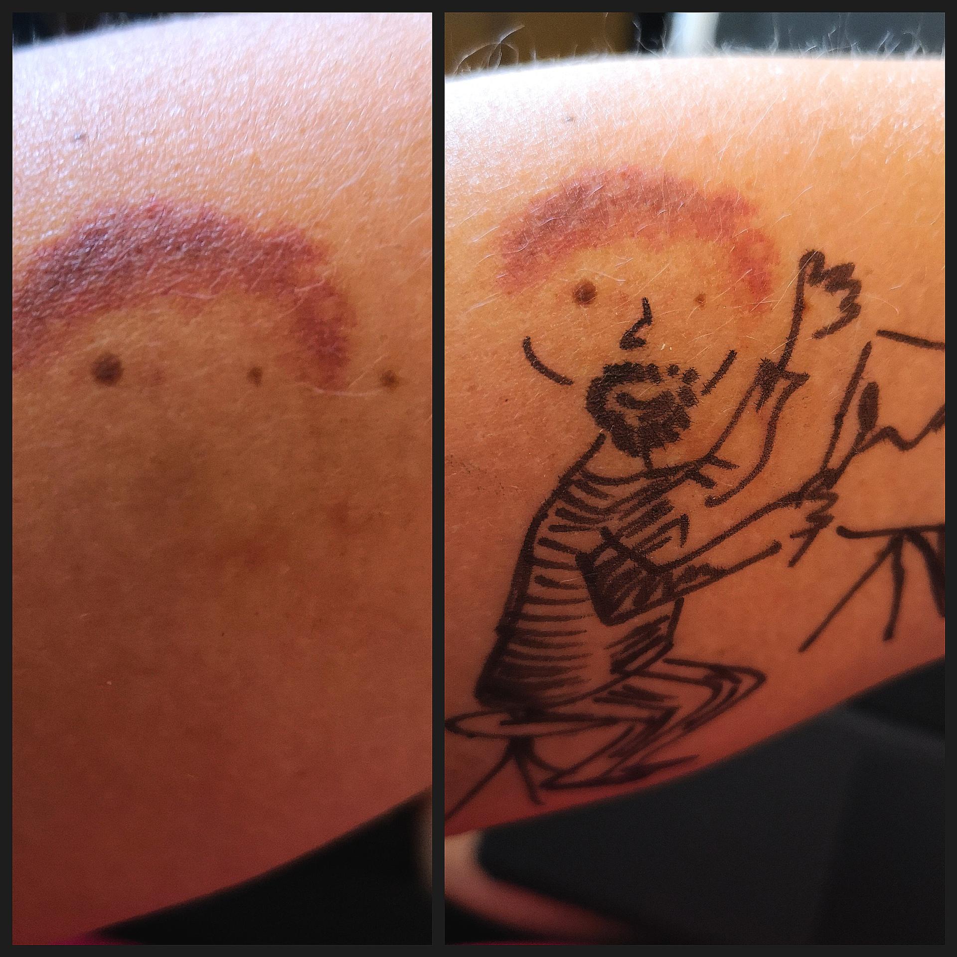 Some people see a bruise... | Scrolller