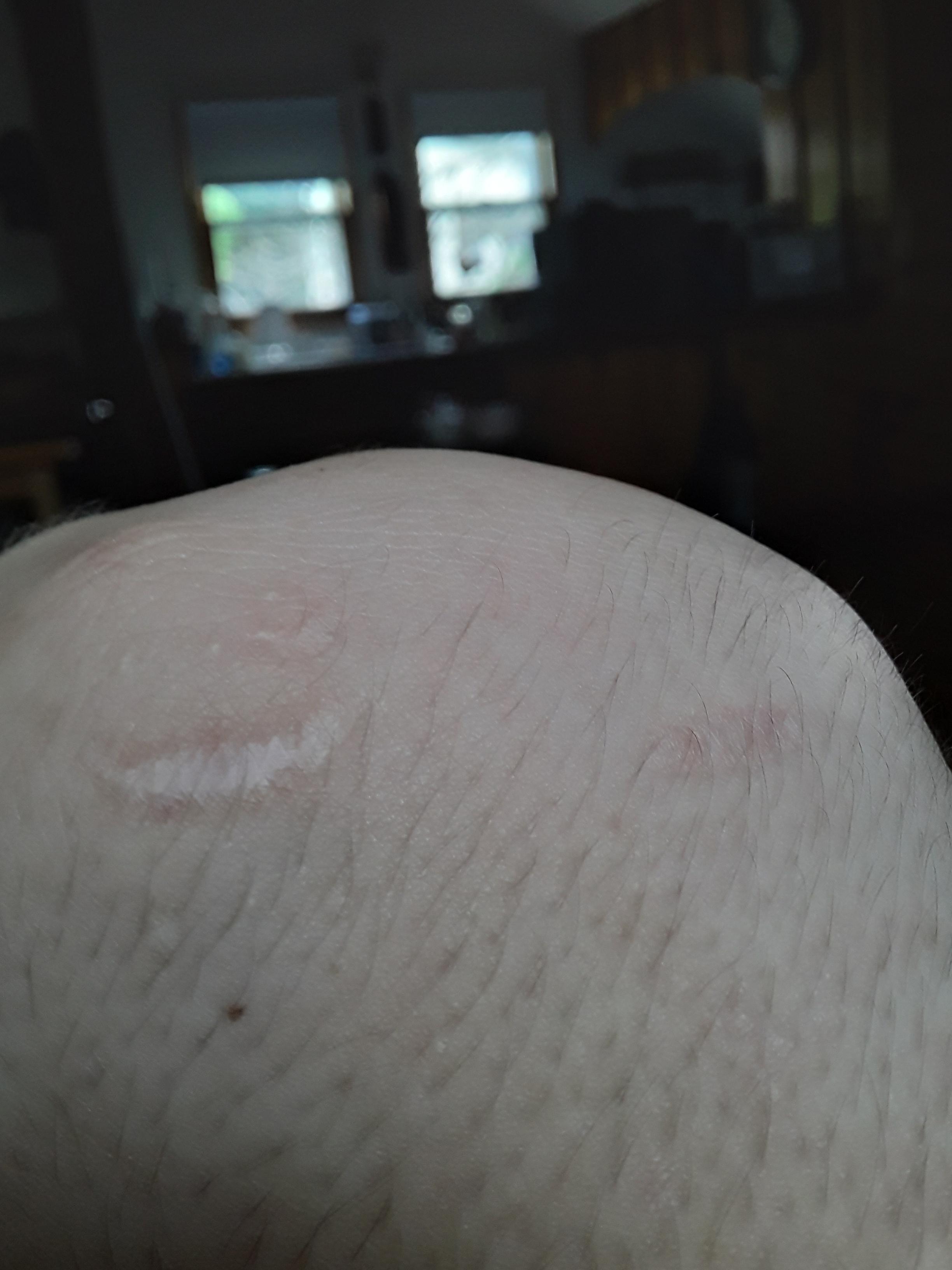 Stitch scars from two years ago I punched a window | Scrolller