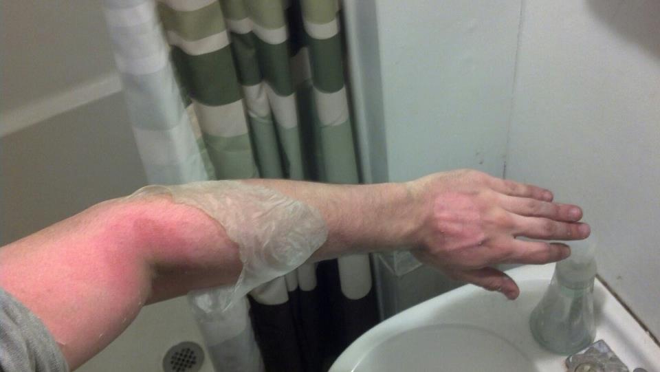 Sunburn (xpost from /r/WTF) | Scrolller
