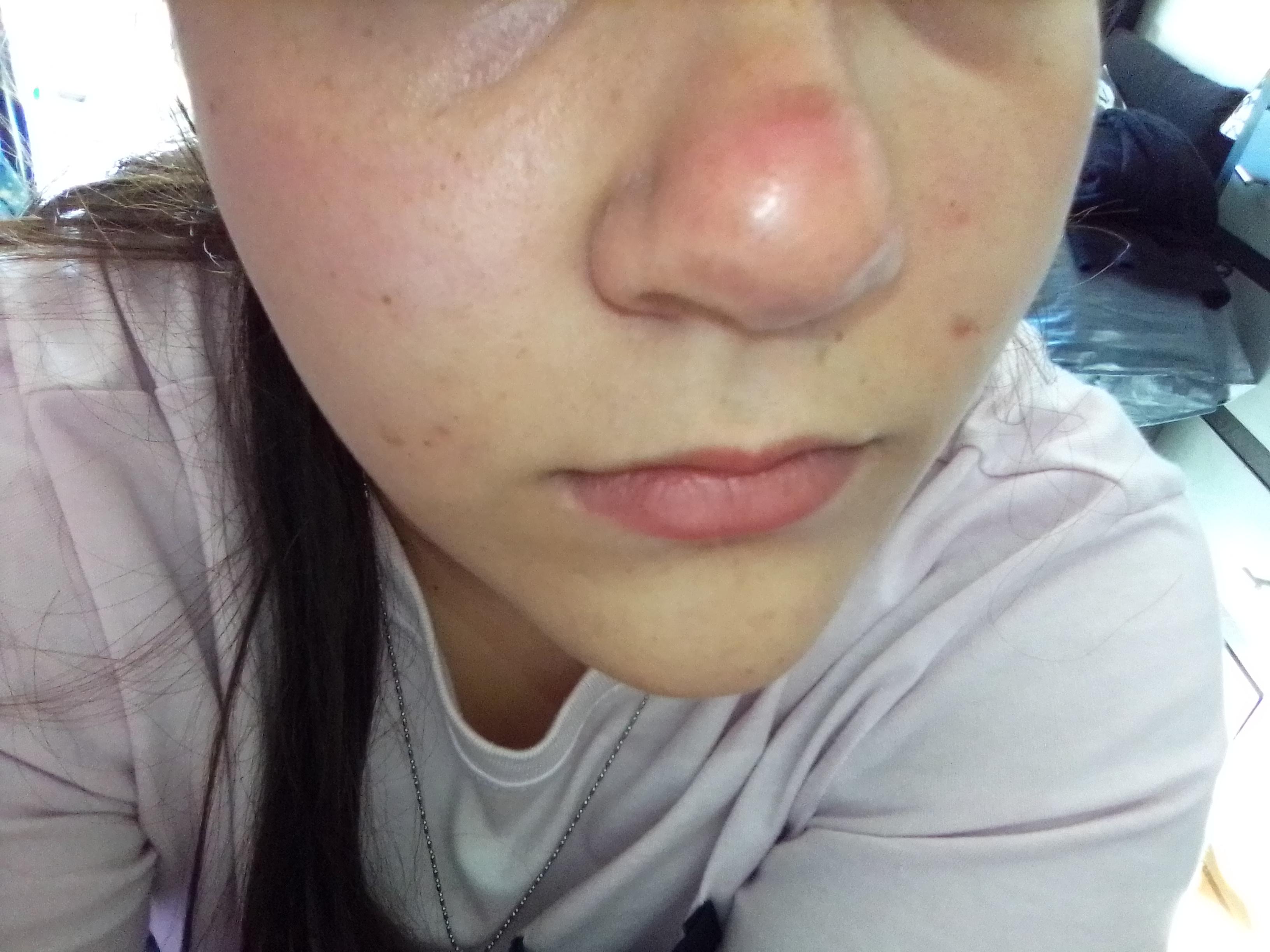 There's something boiling on my nose ;-; | Scrolller