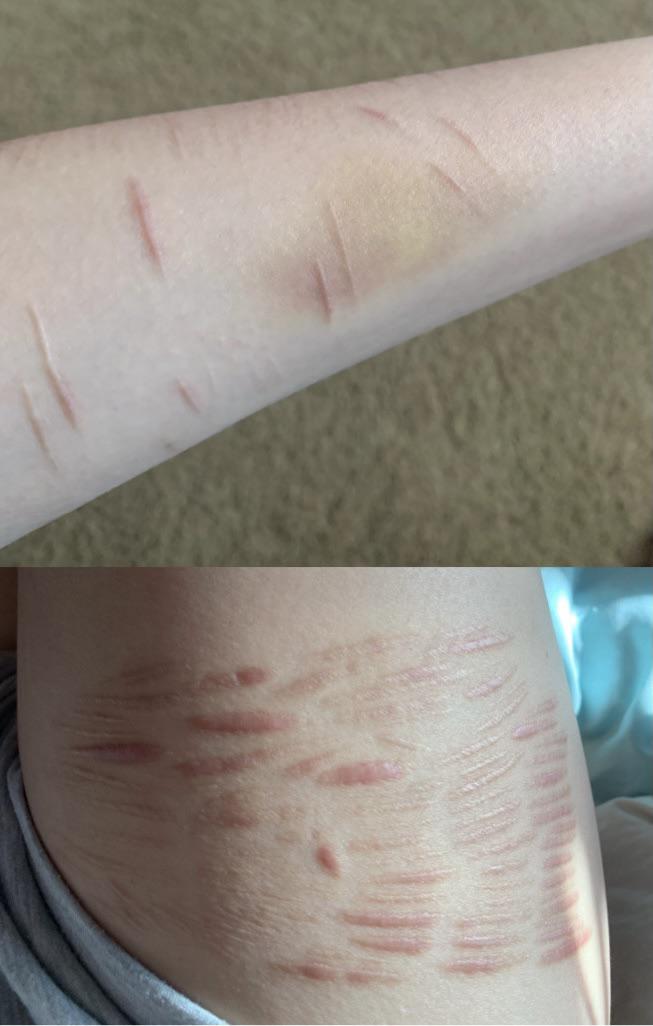 thigh + bruise :( | Scrolller