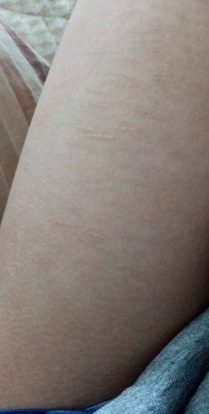 Thigh scars (healed | Scrolller