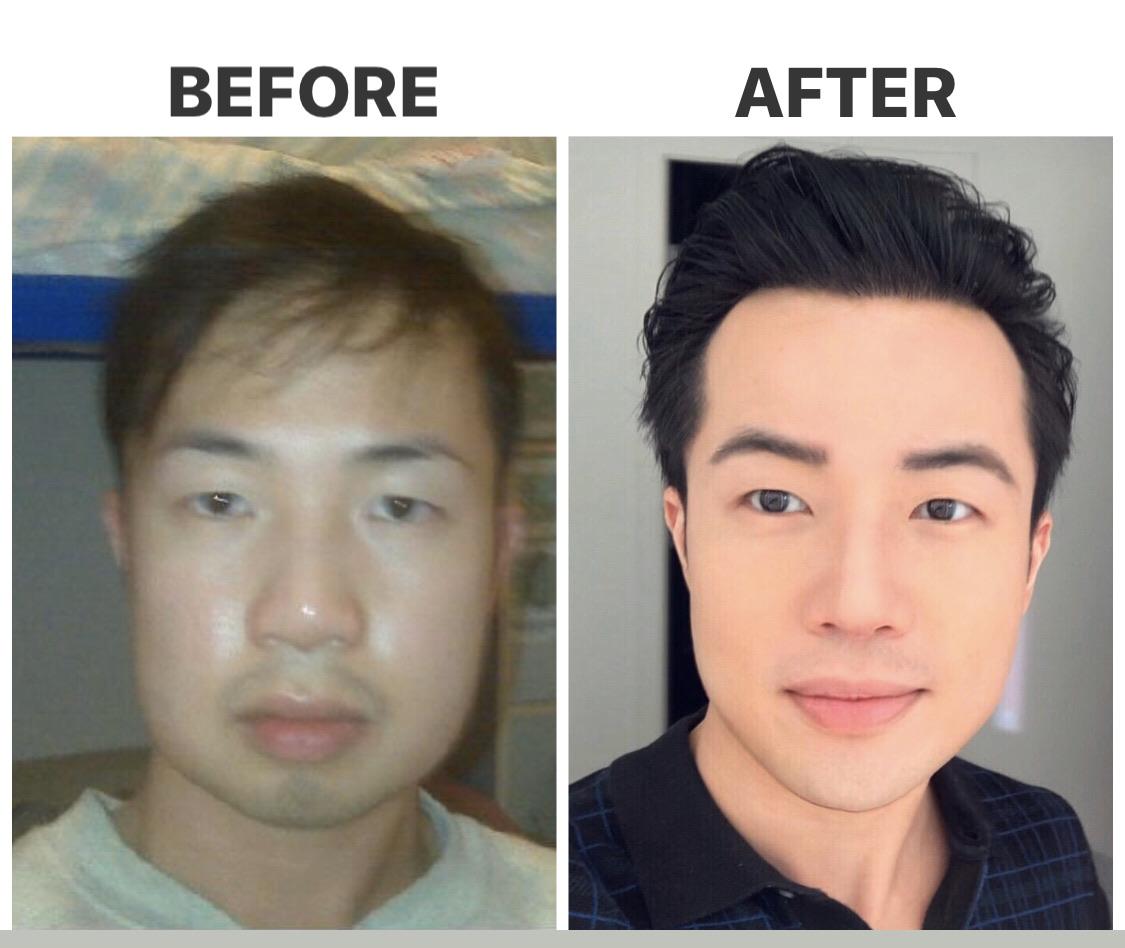 This is me after 10 years of procedures. | Scrolller