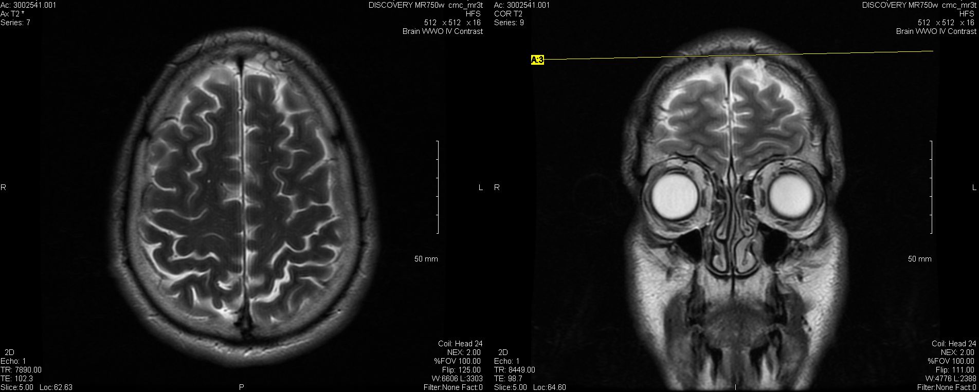 Three spots on forehead in brain MRI, help identify? | Scrolller