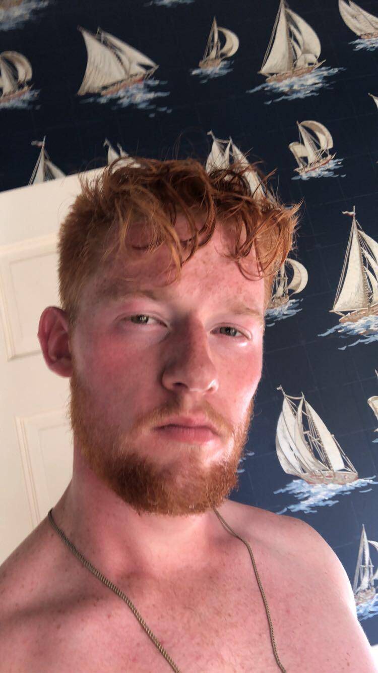 Update: still burnt 🥵 | Scrolller