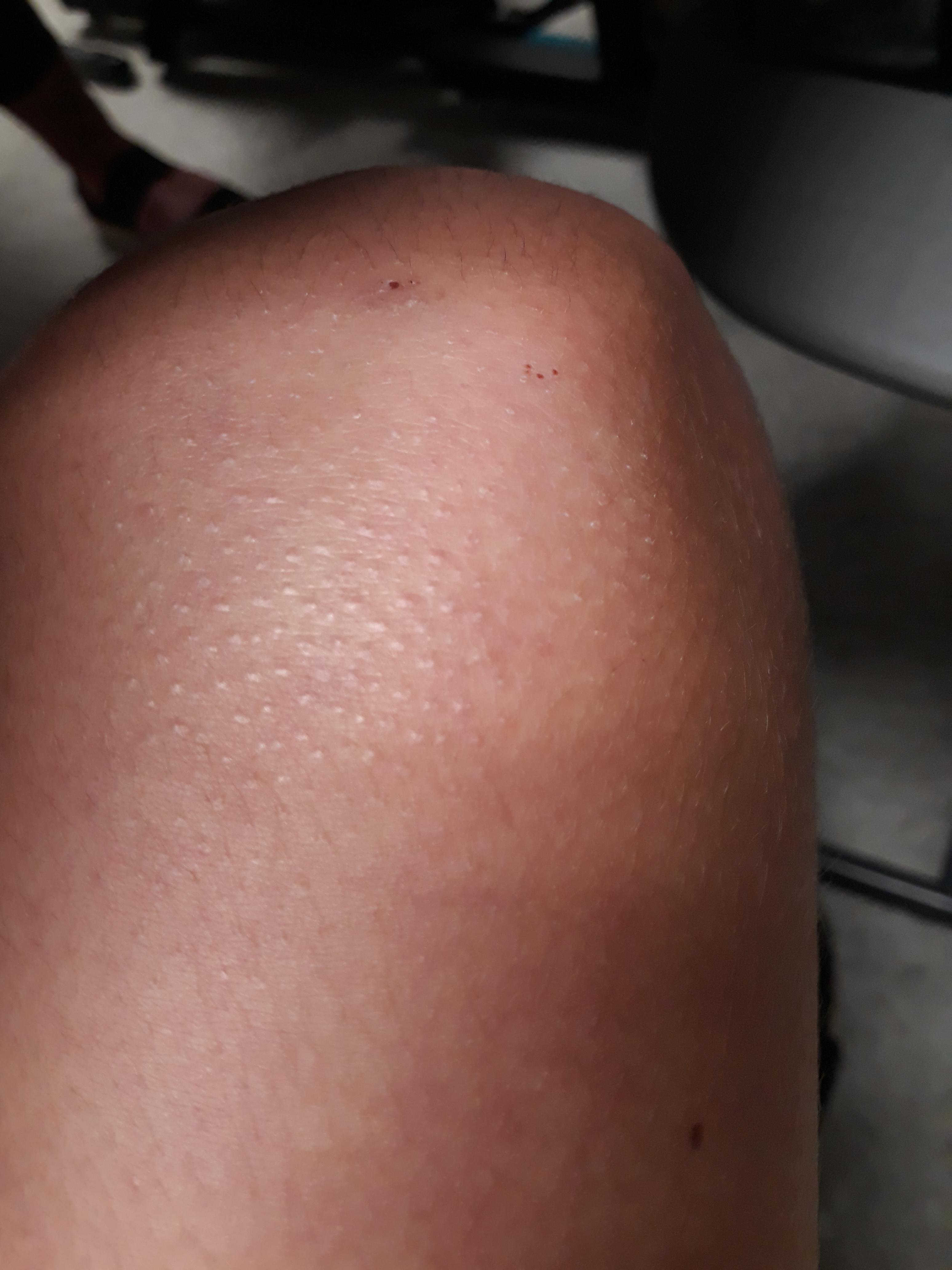 Weird bumps underneath where hair would grow. I'm 15 and have had them for about a year and they ...