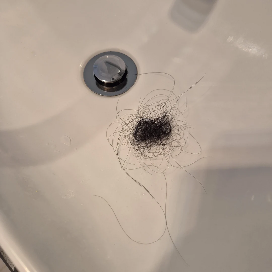 Normal amount of hair shedding? | Scrolller