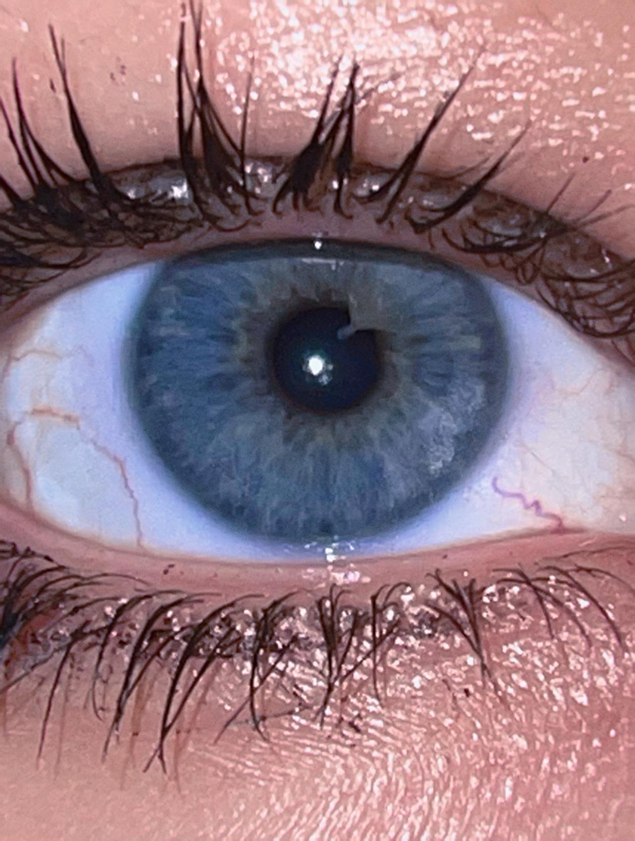 Anyone else have a misshapen Iris? I believe it is Synechiae. Eye doc said I was born with it ...