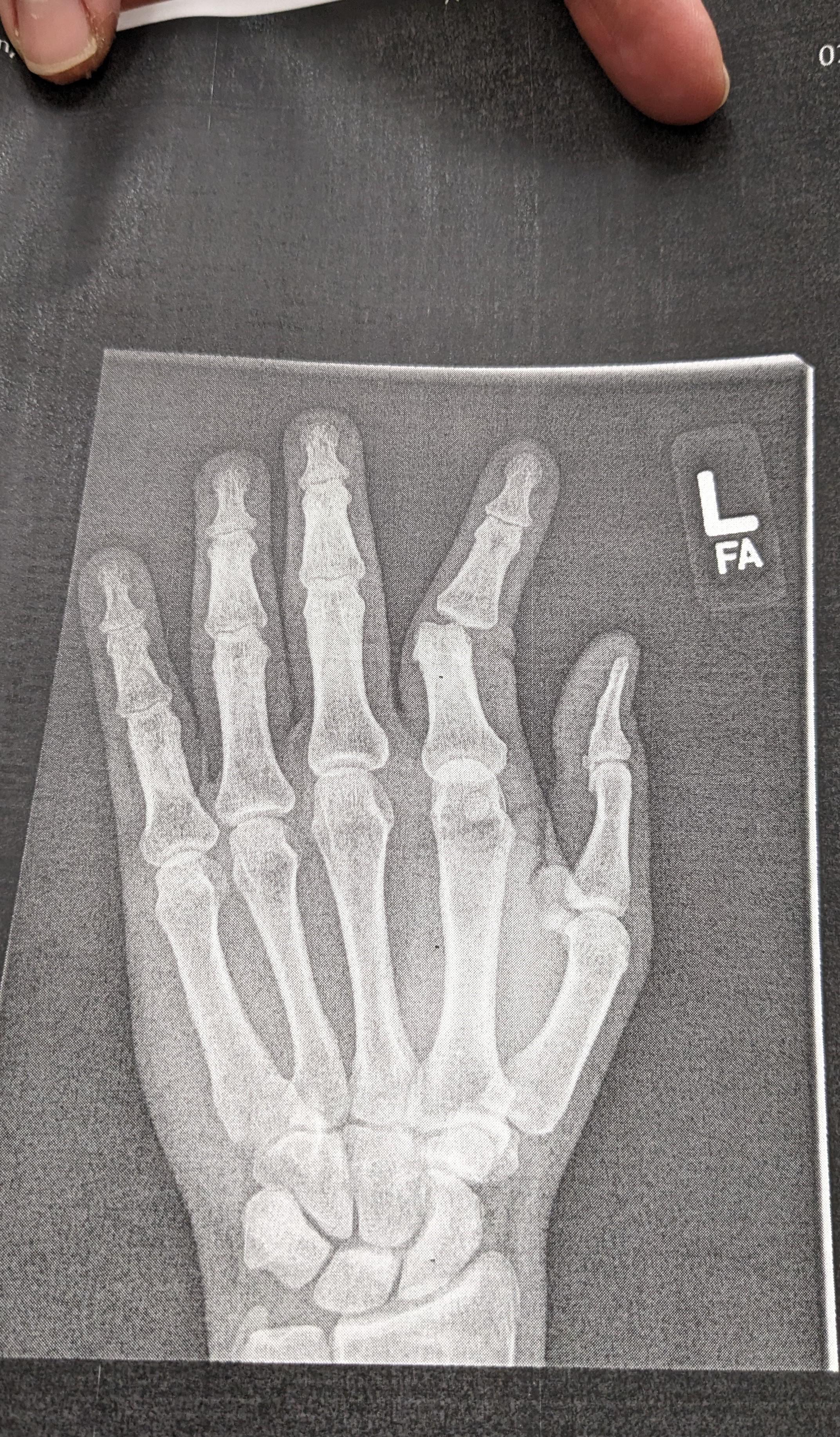 Xray of my dislocated finger. | Scrolller