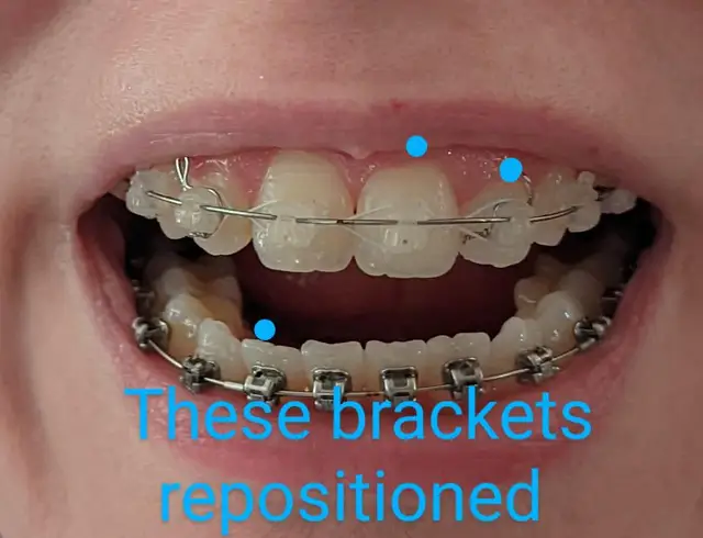 Some adjustments made at my 10 month appointment. 10 months to go. | Scrolller