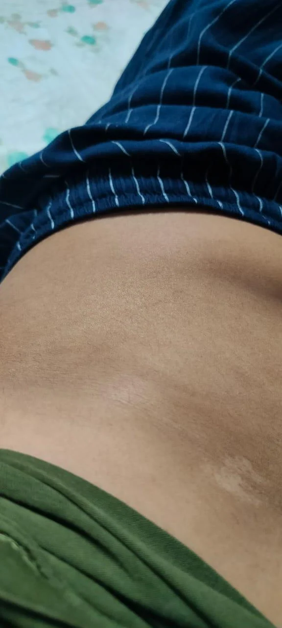 Weird patchy thing on stomach. | Scrolller