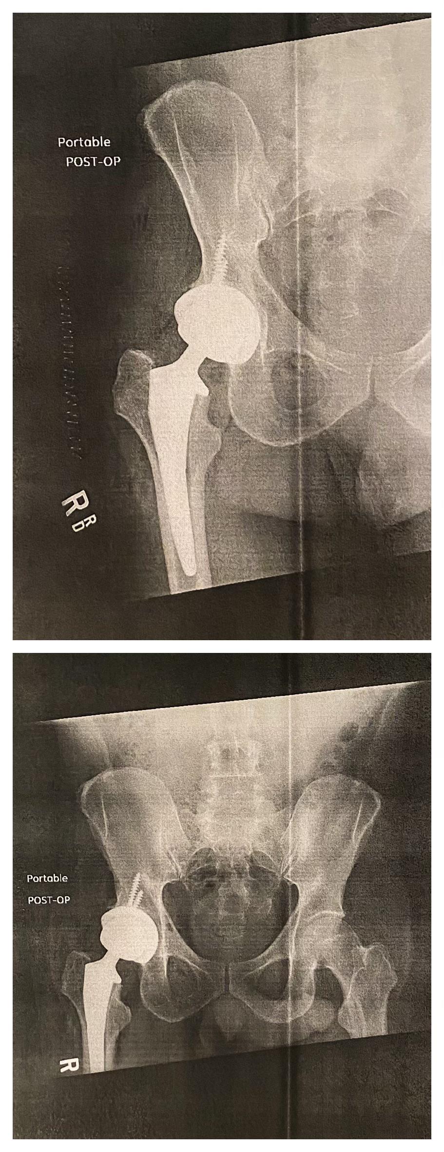 Ok I’ll bite. Two weeks ago I got a new hip | Scrolller