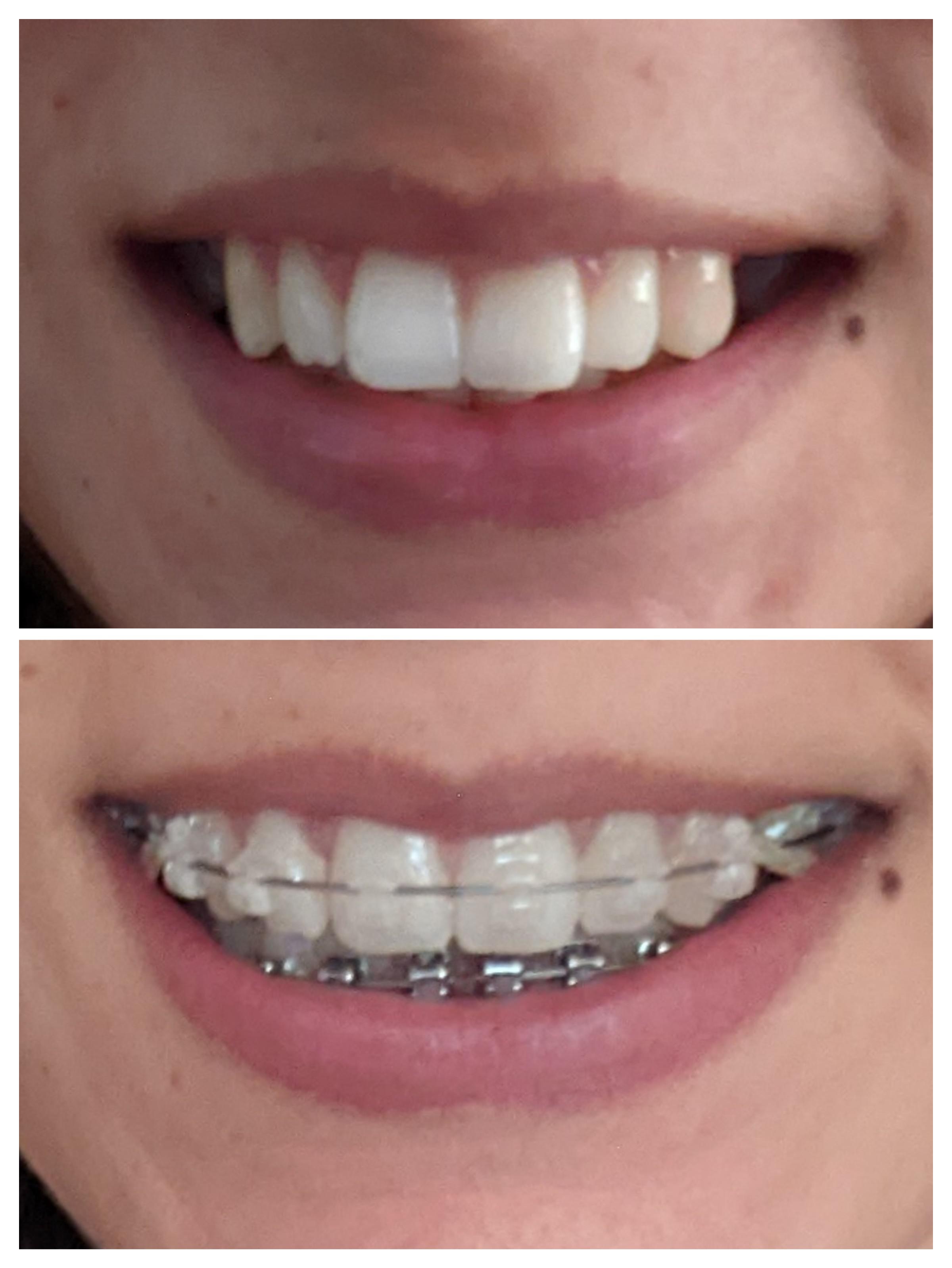 7 month progress with upper premolar extractions! | Scrolller