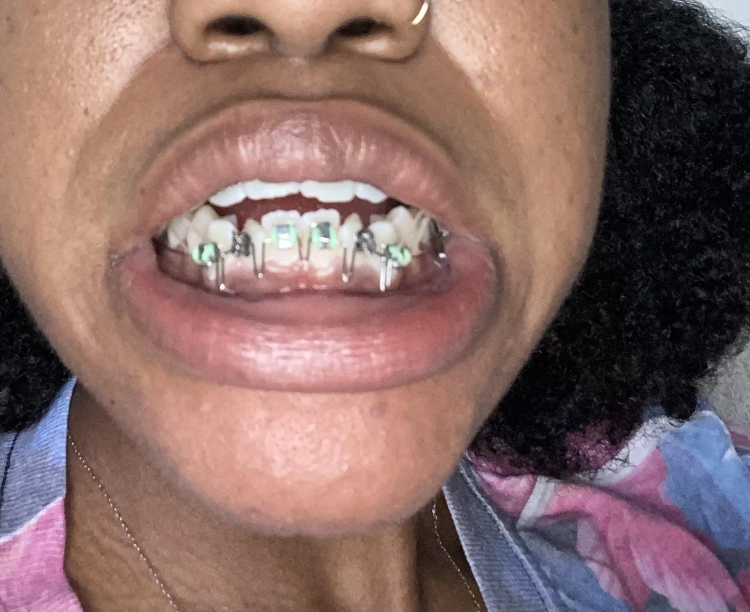 Just Got Braces Scrolller