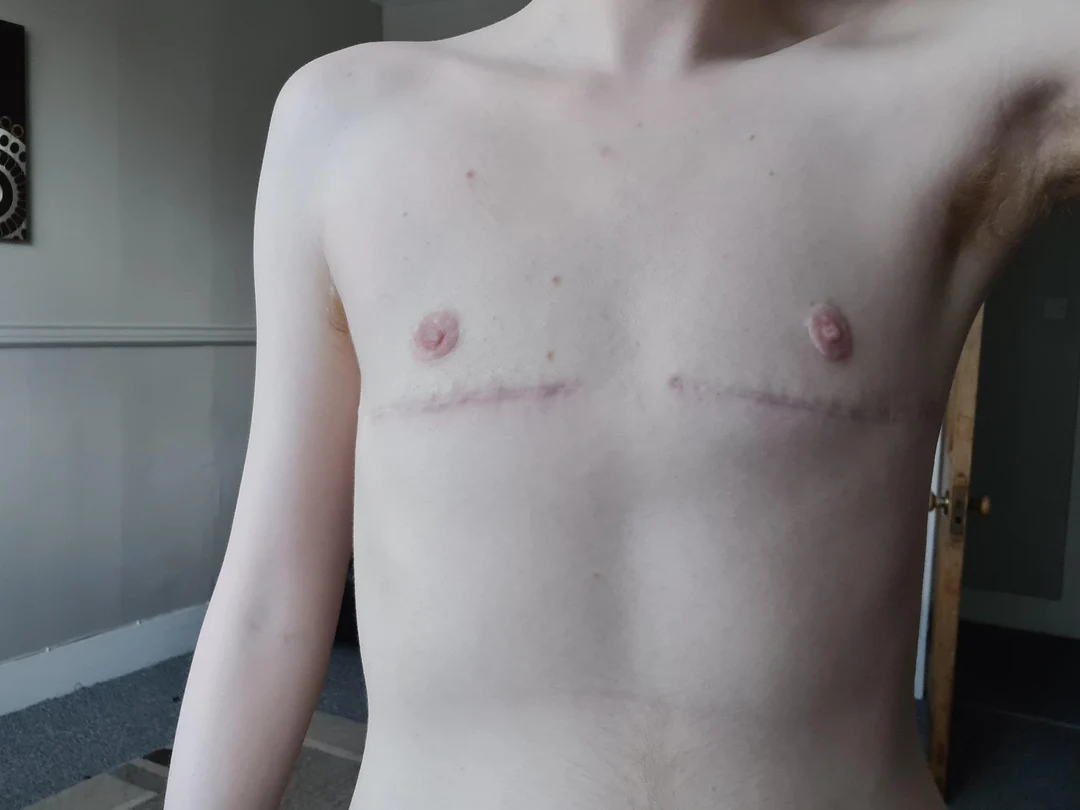 Officially one year post op! | Scrolller