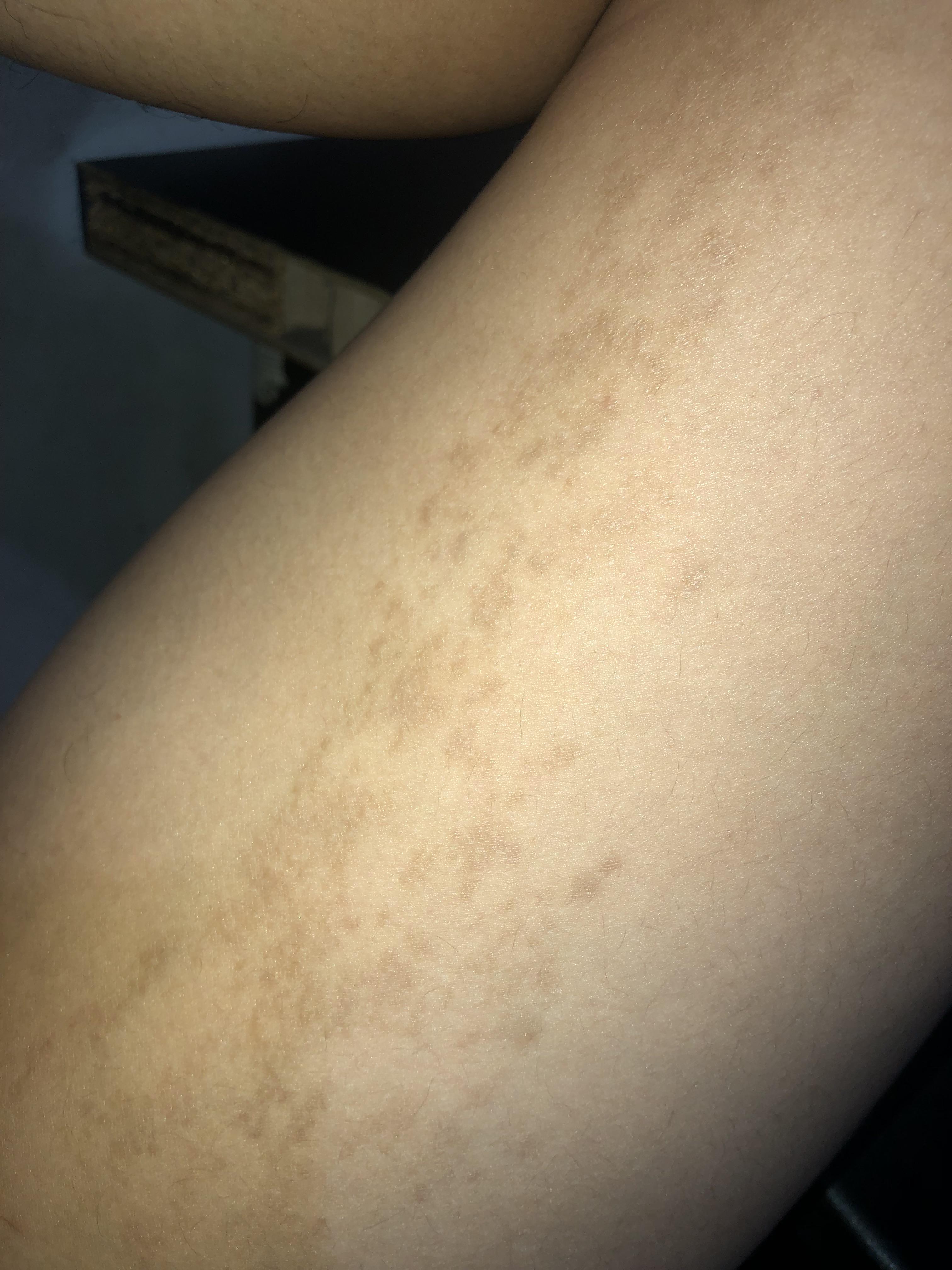 Anyone know what happen to my thigh and have any solution? | Scrolller
