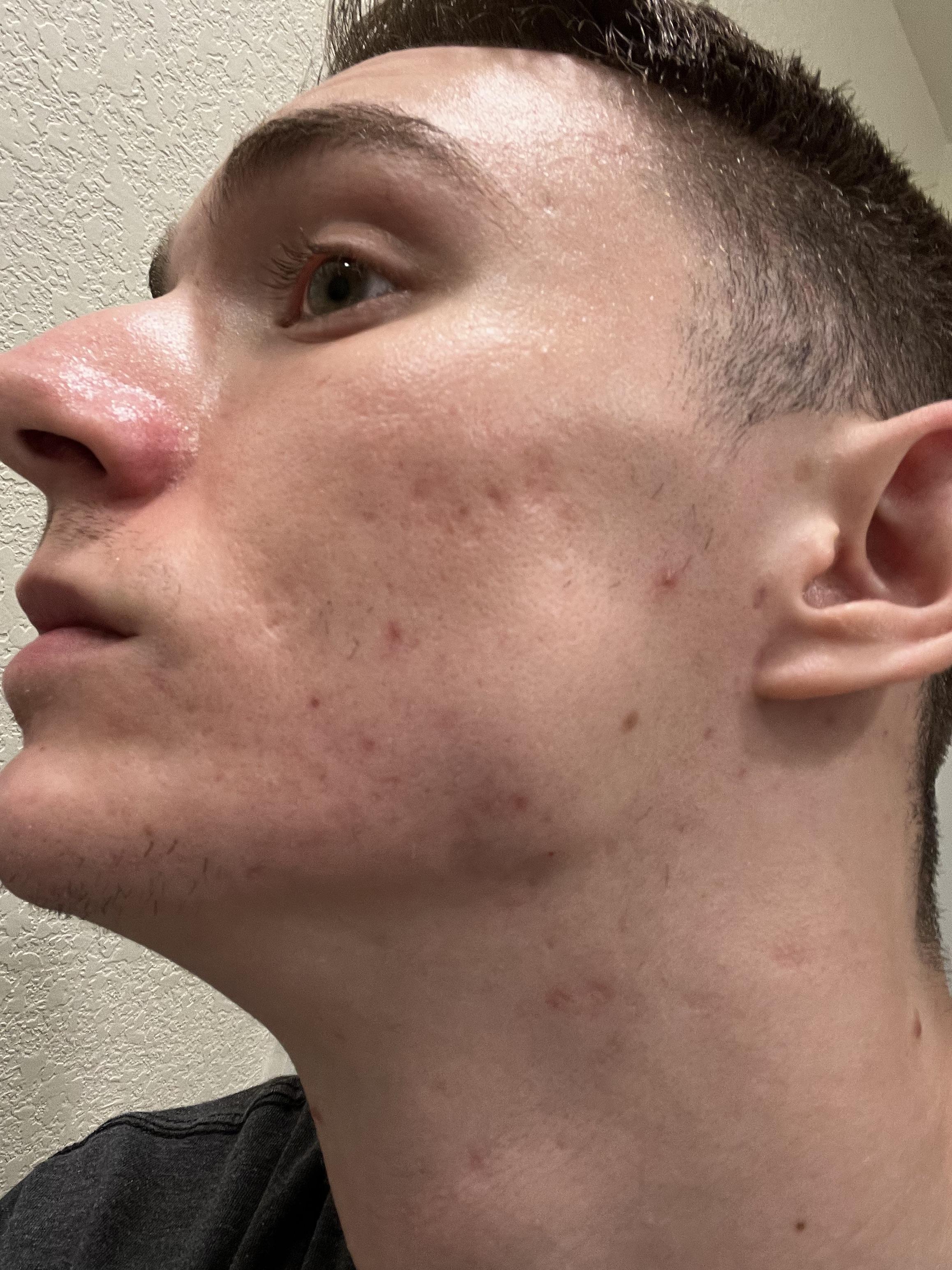 How to get rid of dark spots | Scrolller