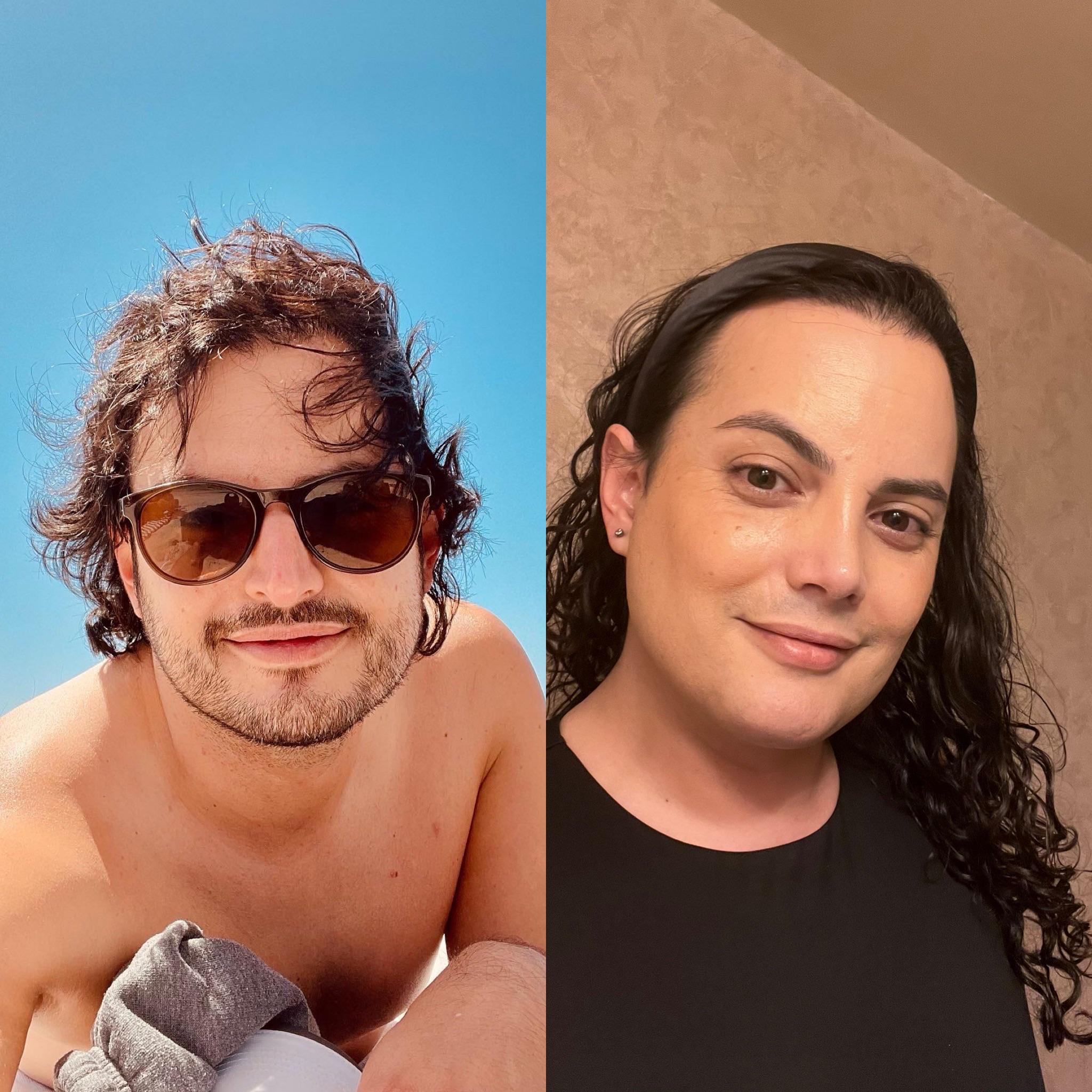 1 year HRT + FFS | Scrolller