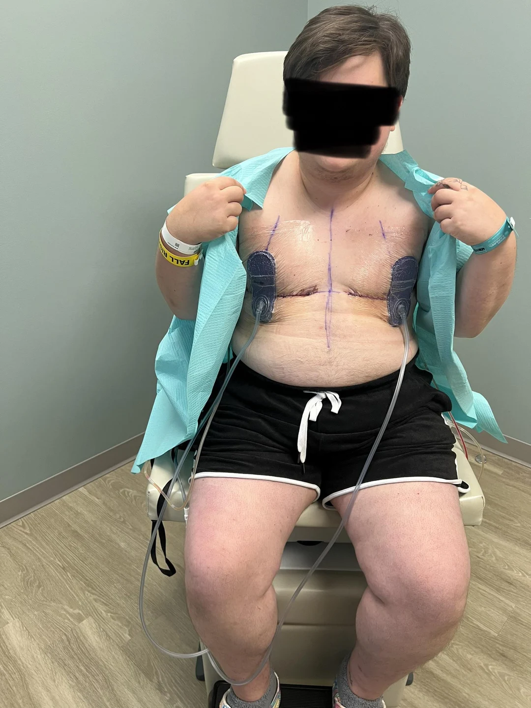 Top Surgery - 2 days post op :) | Scrolller