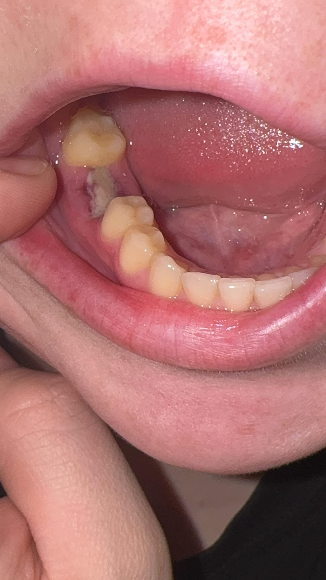 Extracted tooth | Scrolller