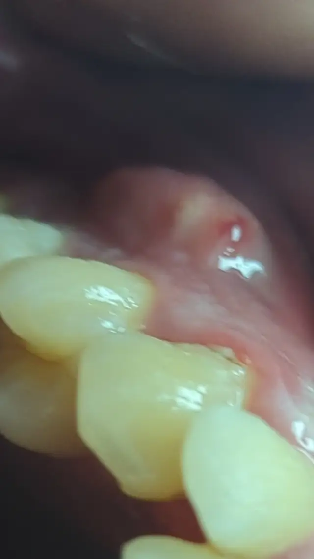 Tooth abscess will see dentist soon | Scrolller