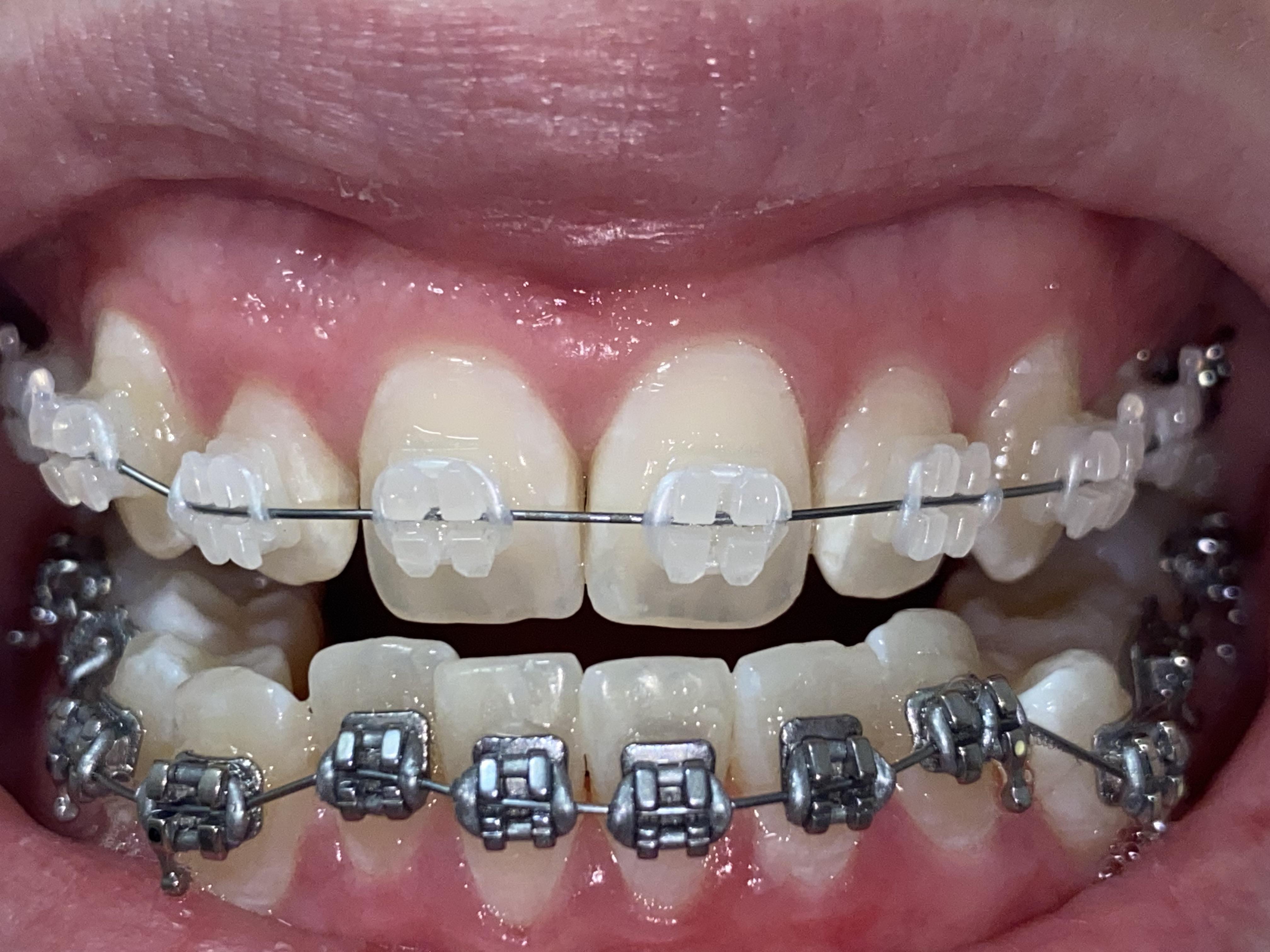 Second Time Having Braces Scrolller