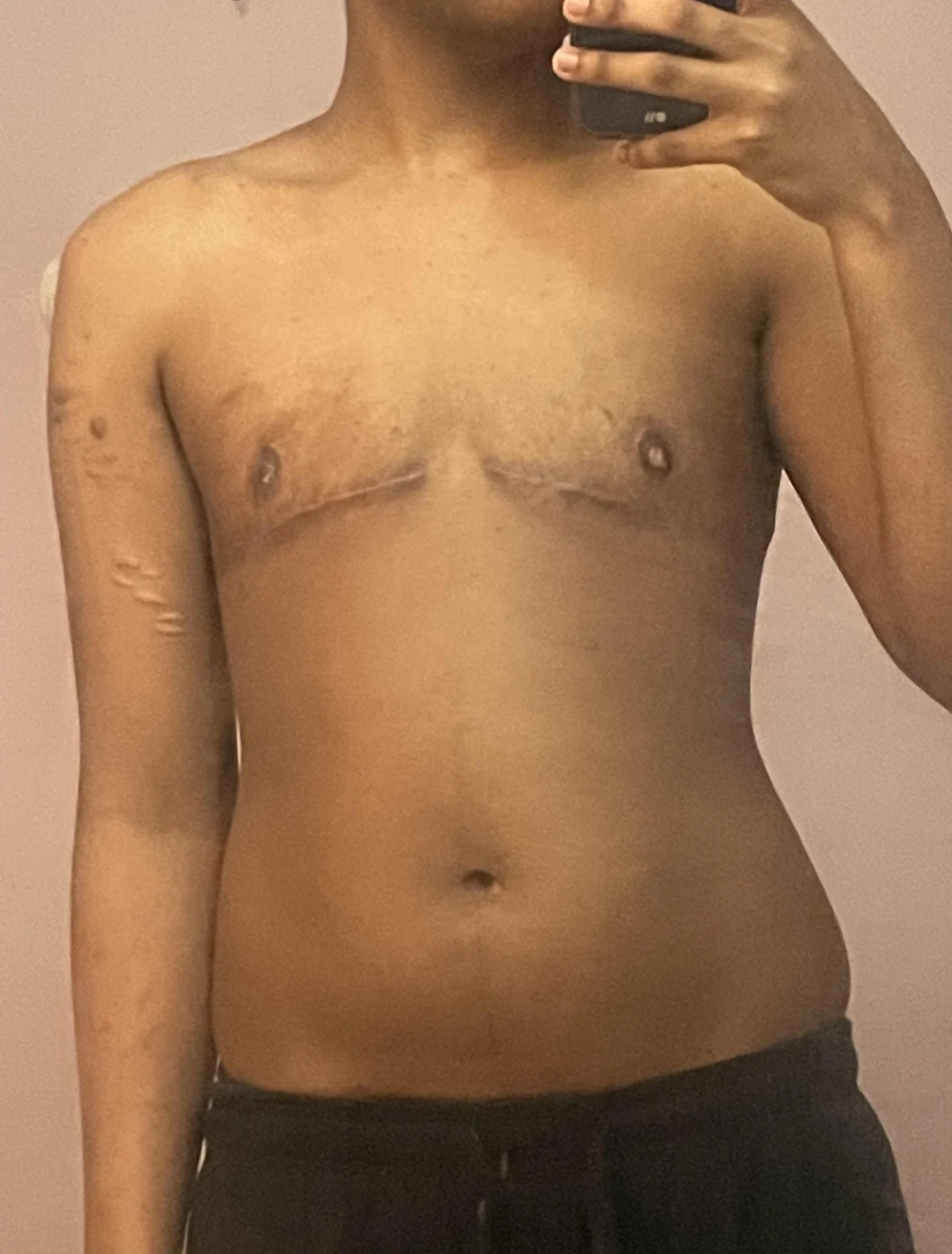 Two months post op | Scrolller